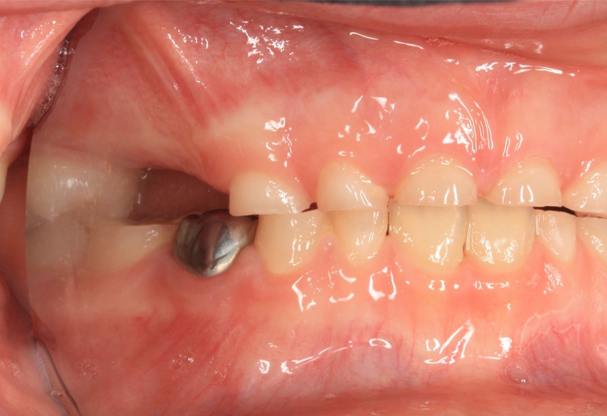 Early Mixed Dentition - Concerns? - Spear Talk