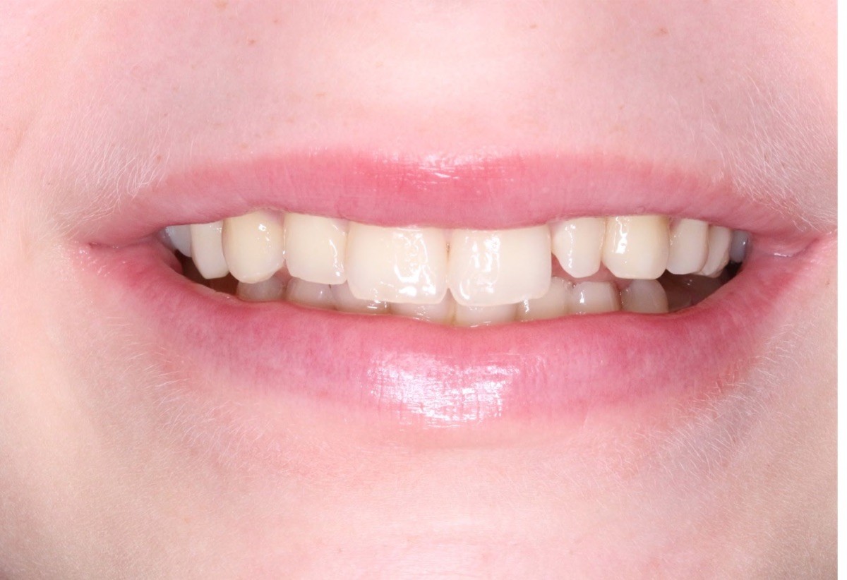 Early Mixed Dentition - Concerns? - Spear Talk