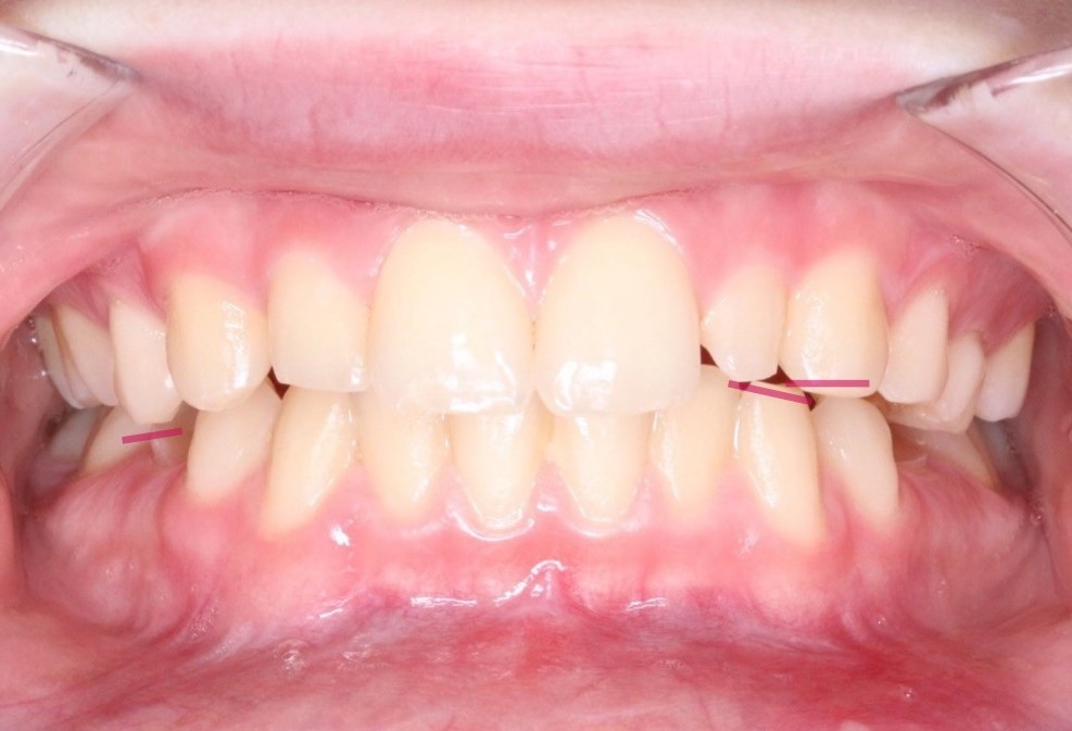 Early Mixed Dentition - Concerns? - Spear Talk