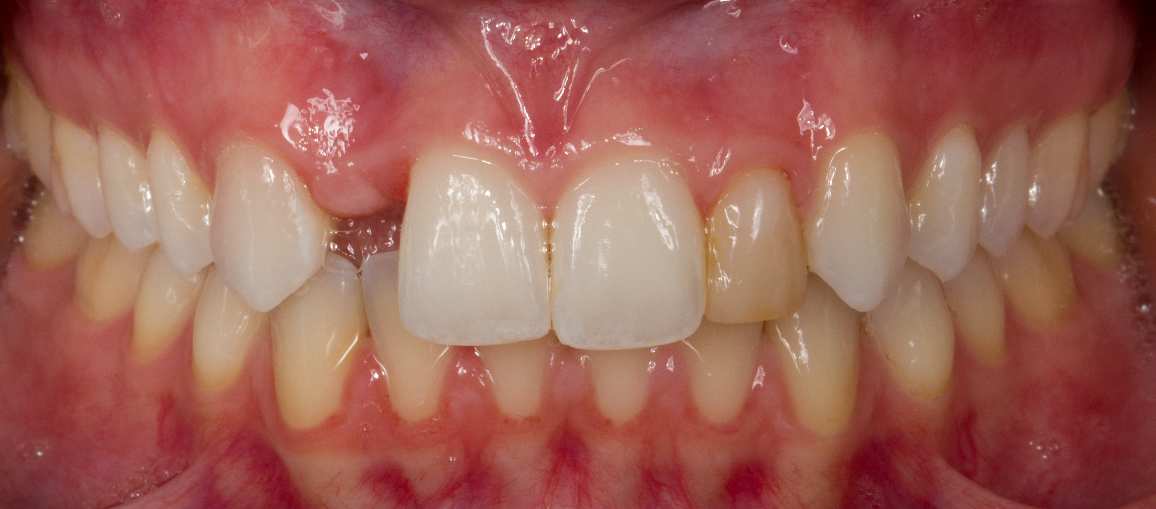 Missing Lateral Incisor... what are the options - Spear Talk