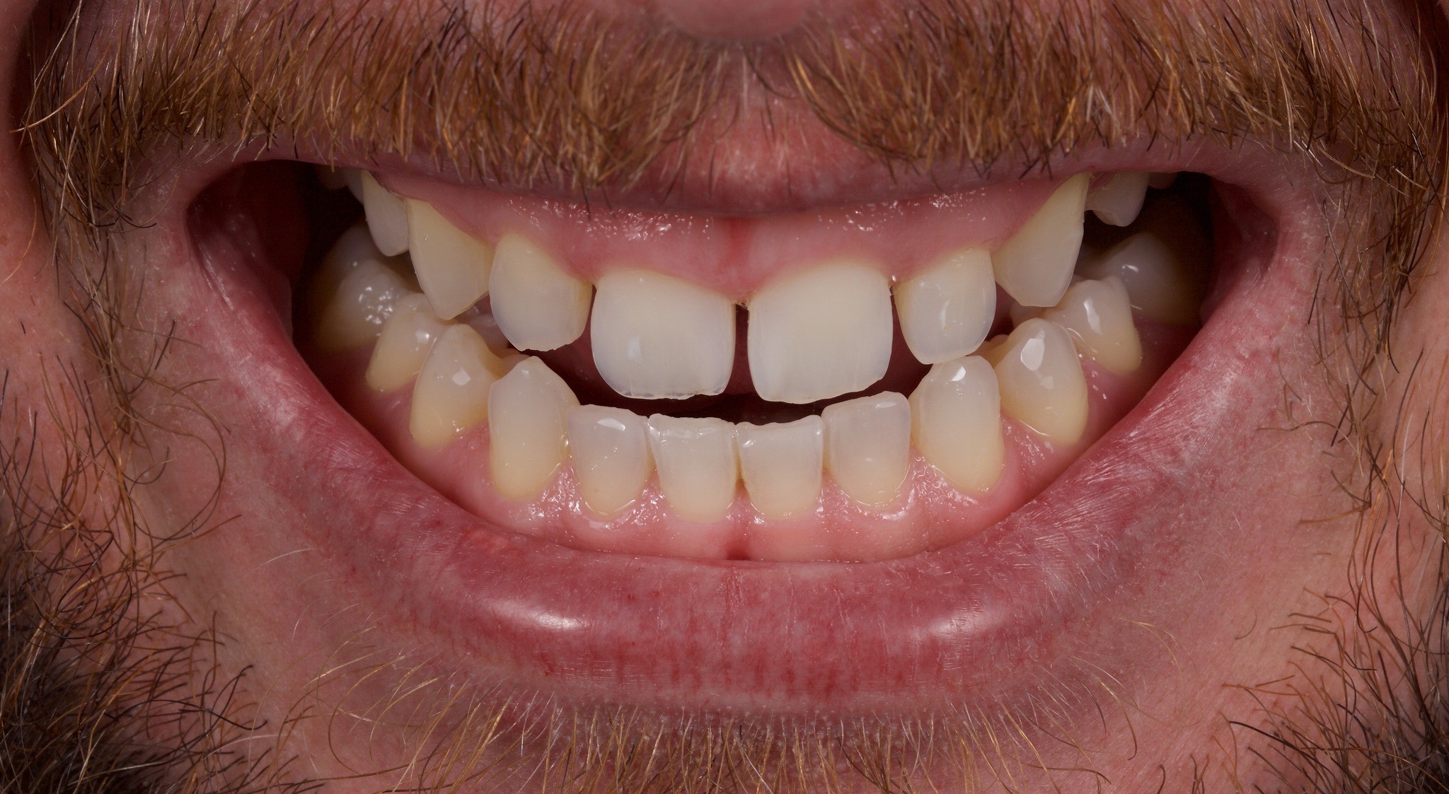 The Potential of Direct Resin. - Spear Talk