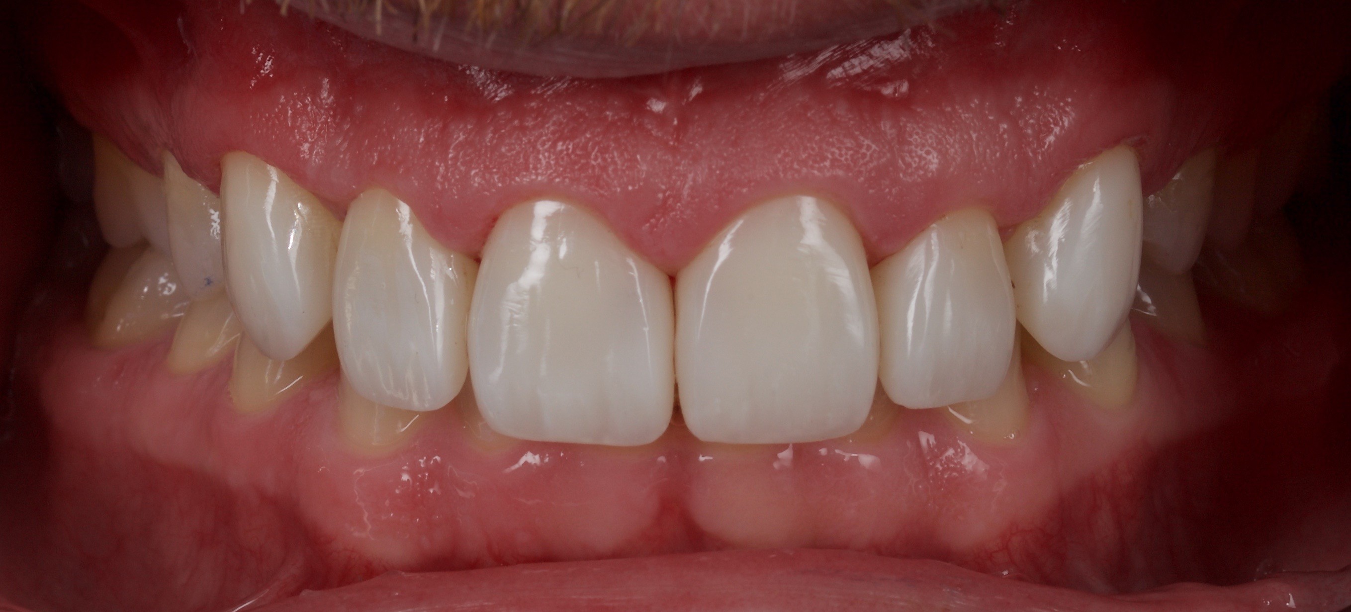 The Potential of Direct Resin. - Spear Talk