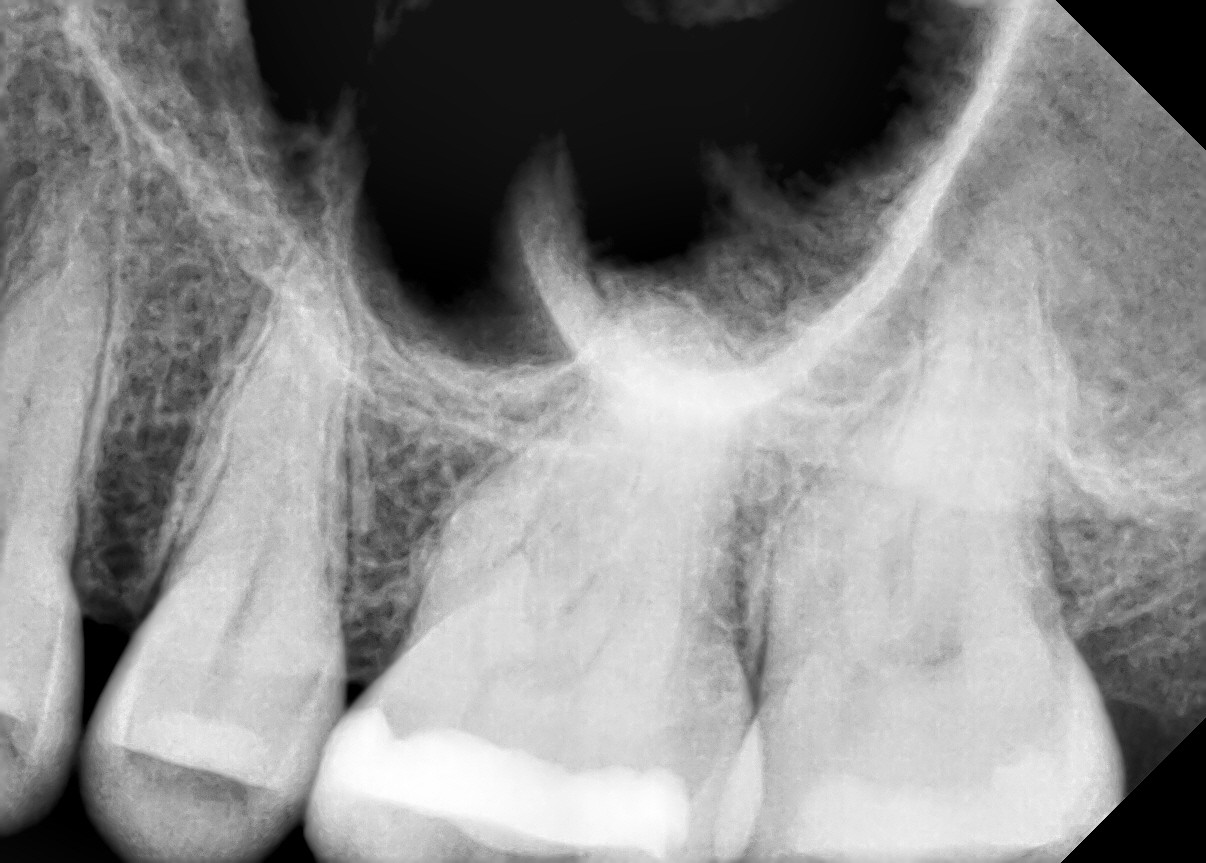 Hot sensitivity after restorations - Spear Talk