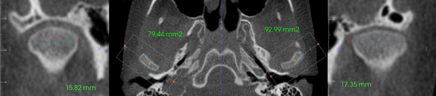 11 year old pre-ortho evaluation - Spear Talk