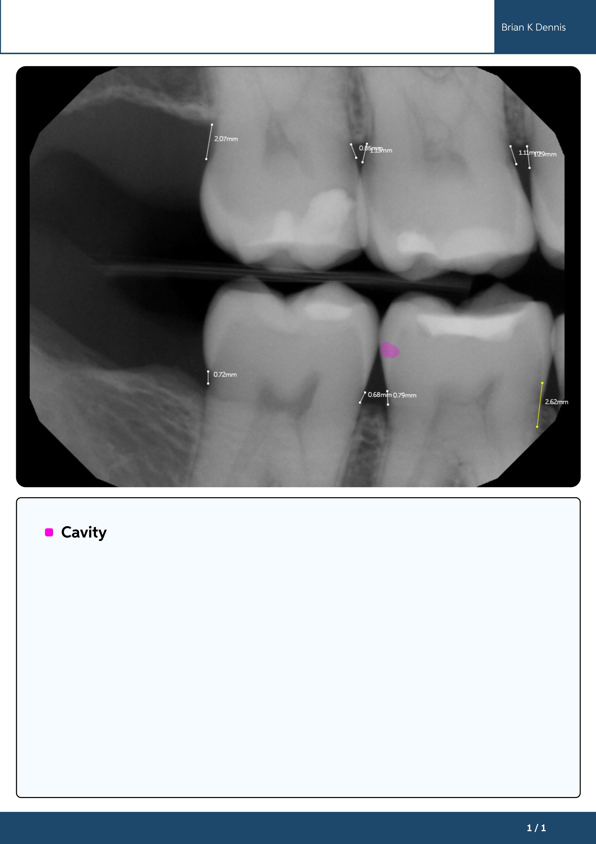 Using AI in caries detection, radiographically and clinically - Spear Talk