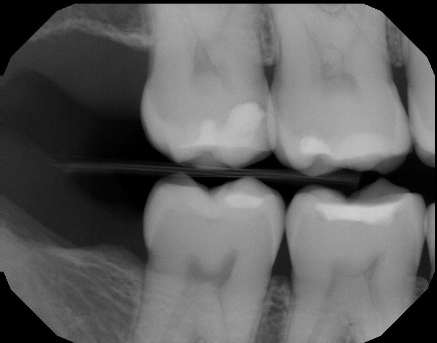 Using AI in caries detection, radiographically and clinically - Spear Talk