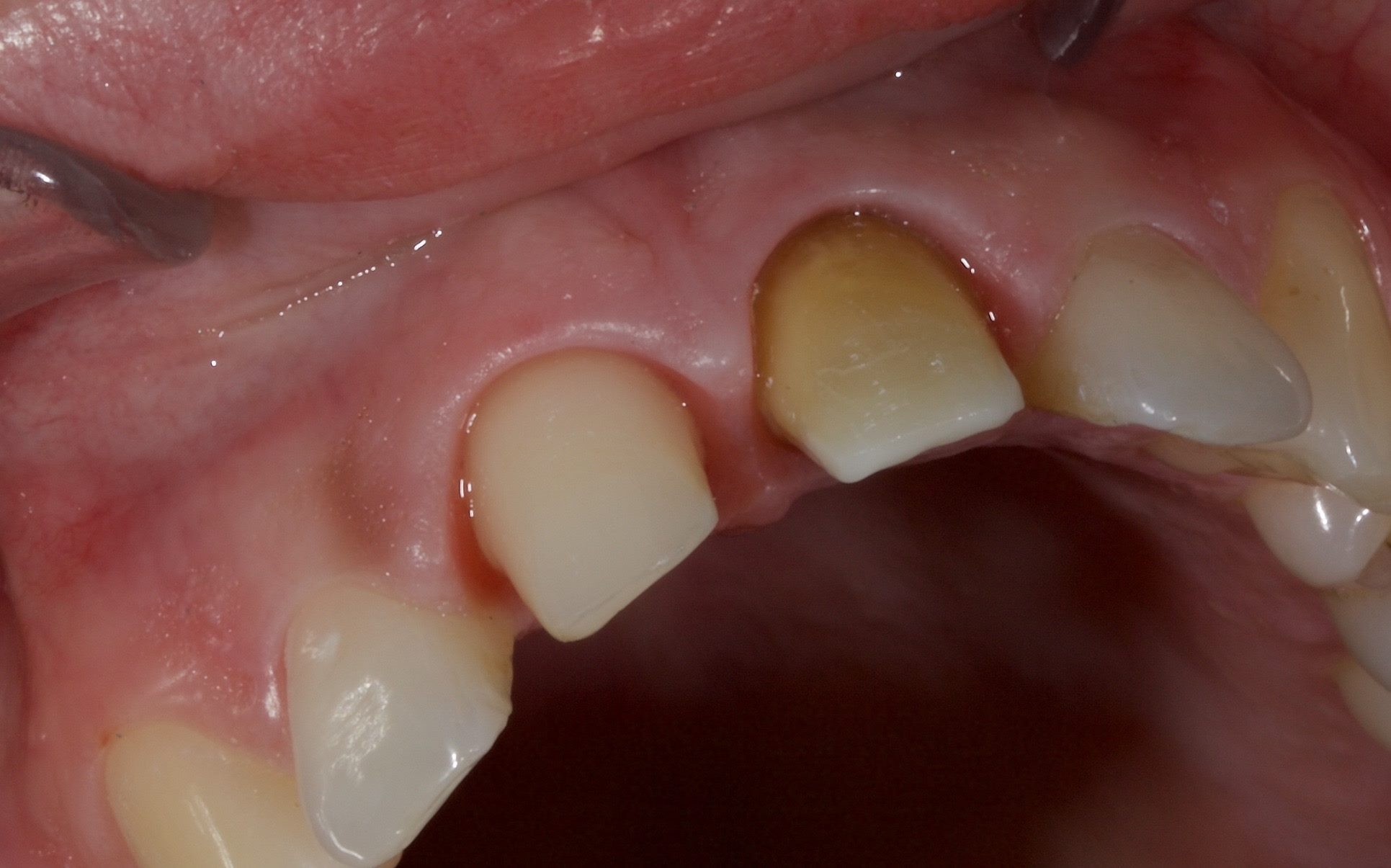 Vertical Margins in Fixed Prosthodontics - Spear Talk