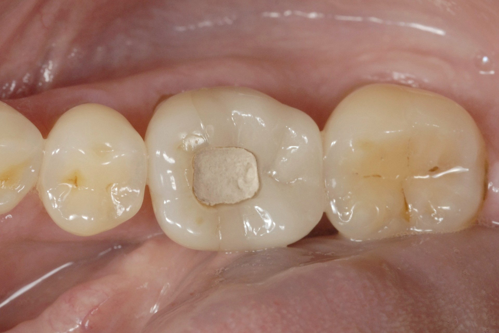 Temporary cementation of non-retentive onlay provisionals - Spear Talk