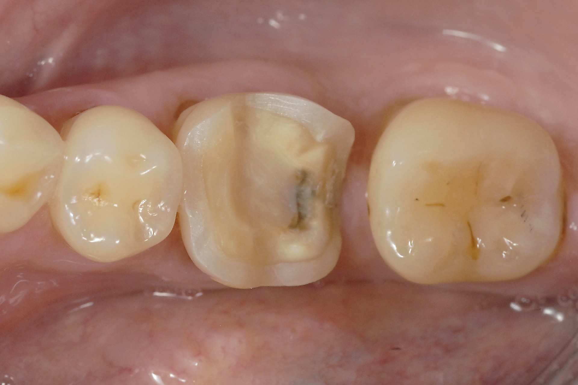 Temporary cementation of non-retentive onlay provisionals - Spear Talk