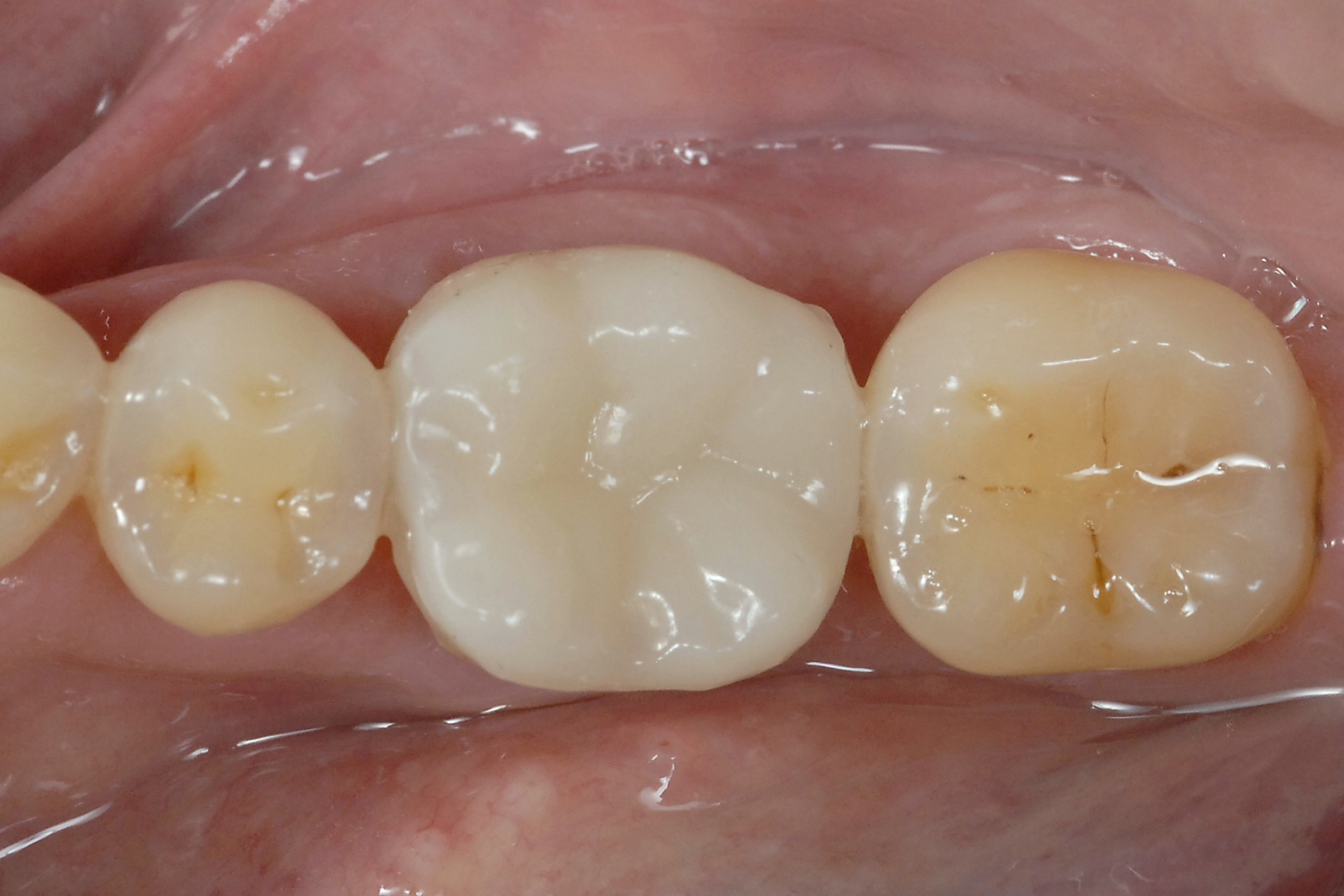 Temporary cementation of non-retentive onlay provisionals - Spear Talk