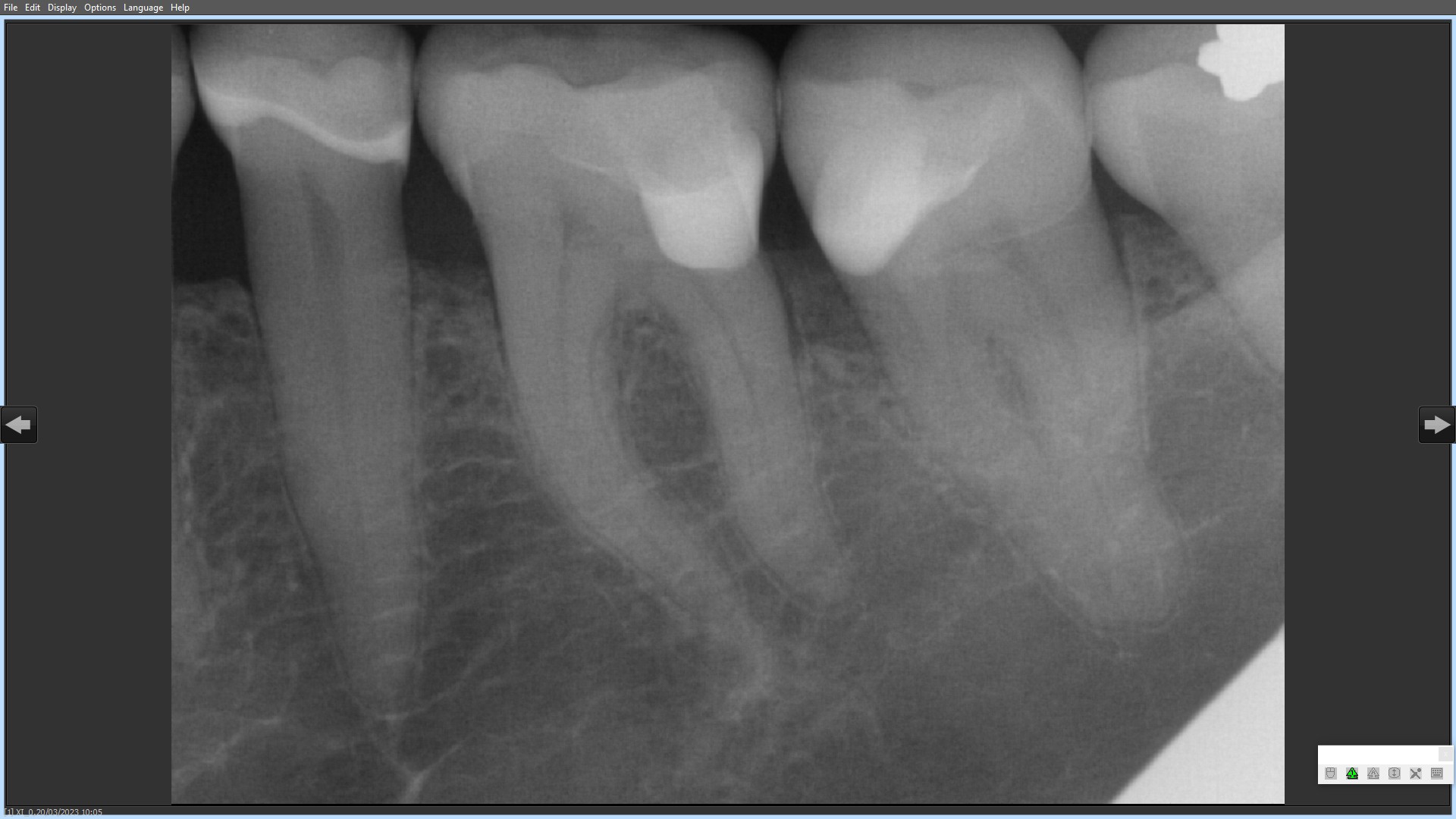 Gingival Margin Elevation - Spear Talk