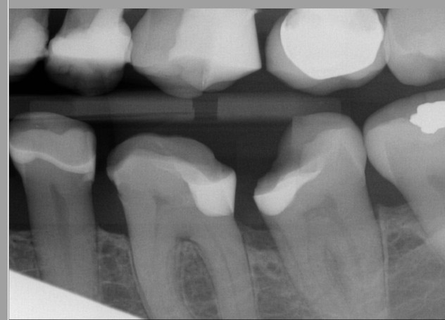 Gingival Margin Elevation - Spear Talk
