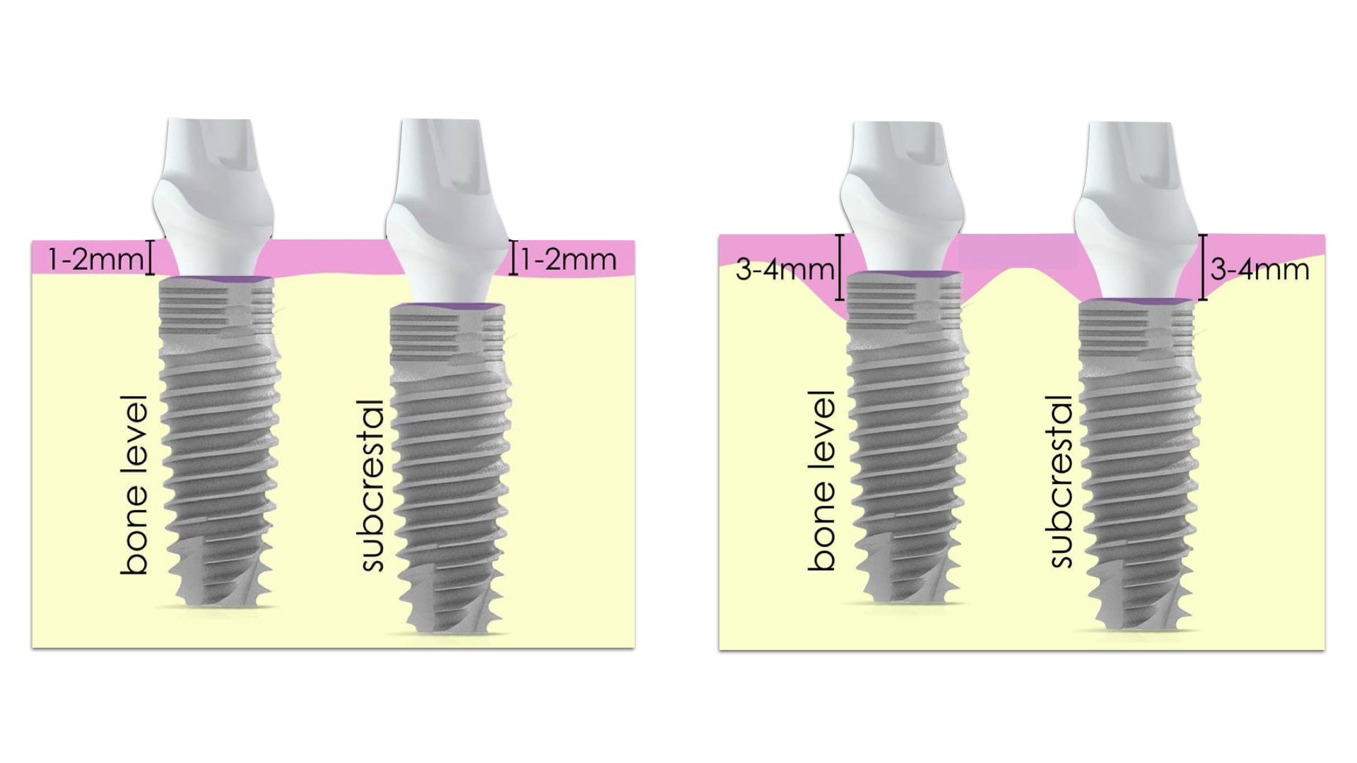 How to determine Implant Placement Depth - Spear Talk