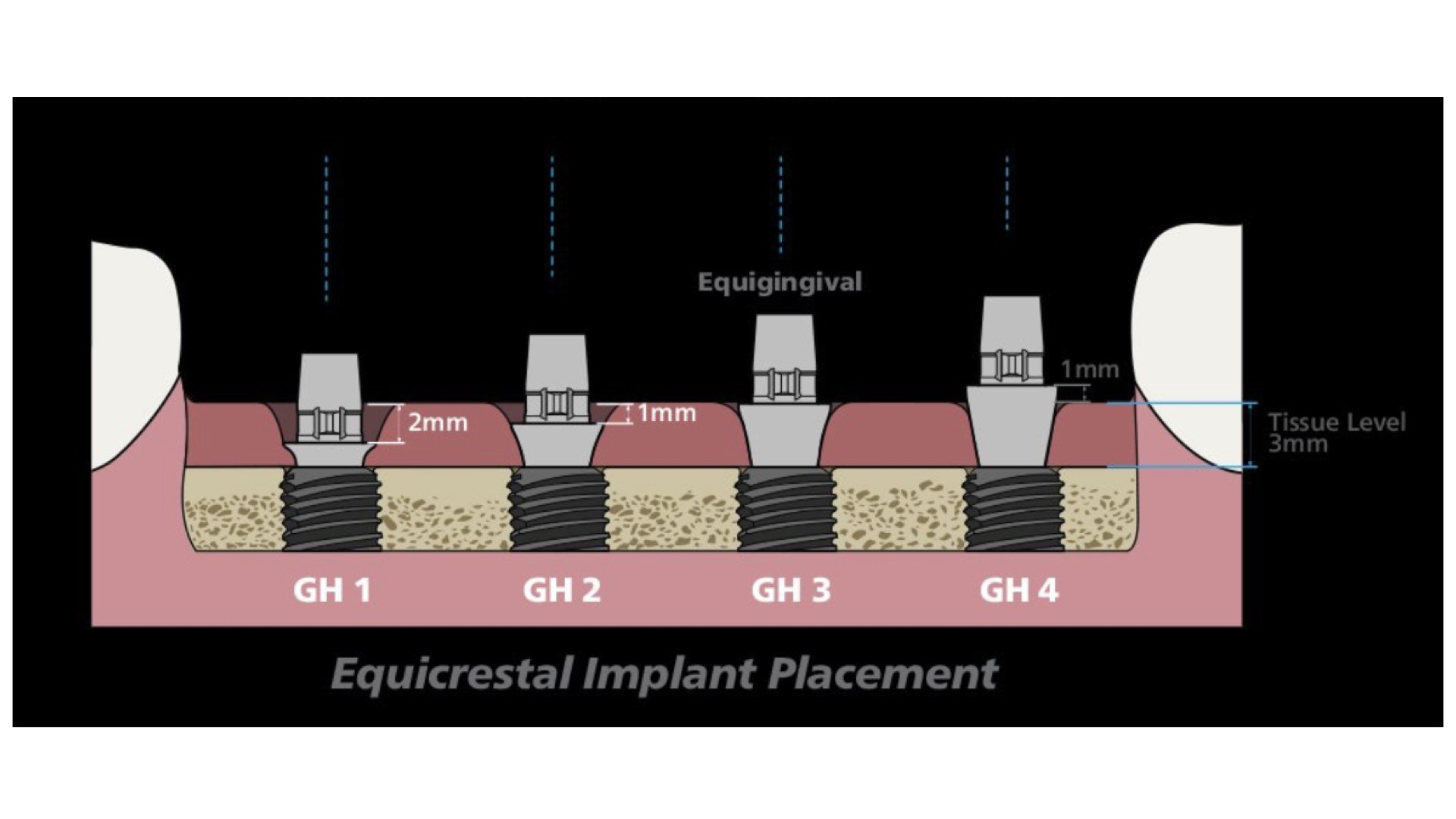 How to determine Implant Placement Depth - Spear Talk