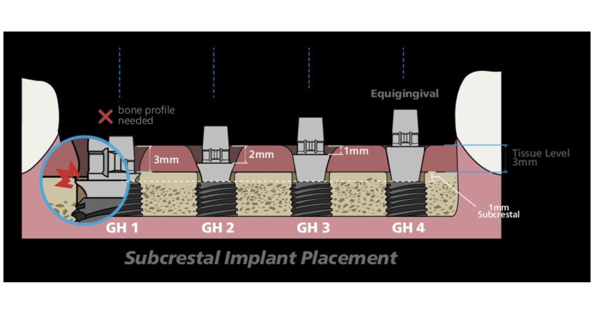 How to determine Implant Placement Depth - Spear Talk