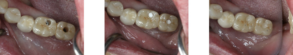 Screw retained Implant Crowns - Spear Talk