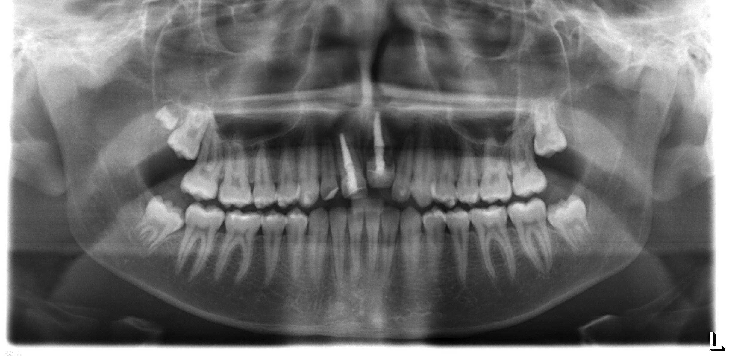 Treatment Planning: ankylosed central incisor - Spear Talk