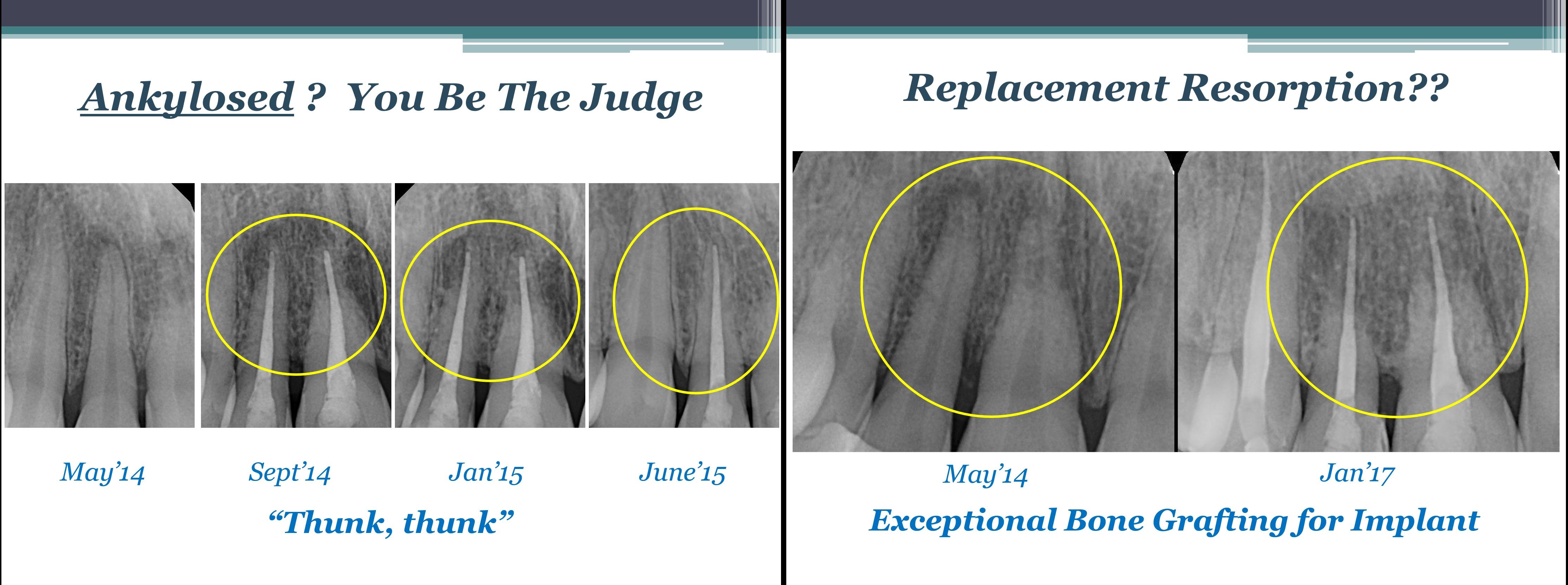 Treatment Planning: ankylosed central incisor - Spear Talk