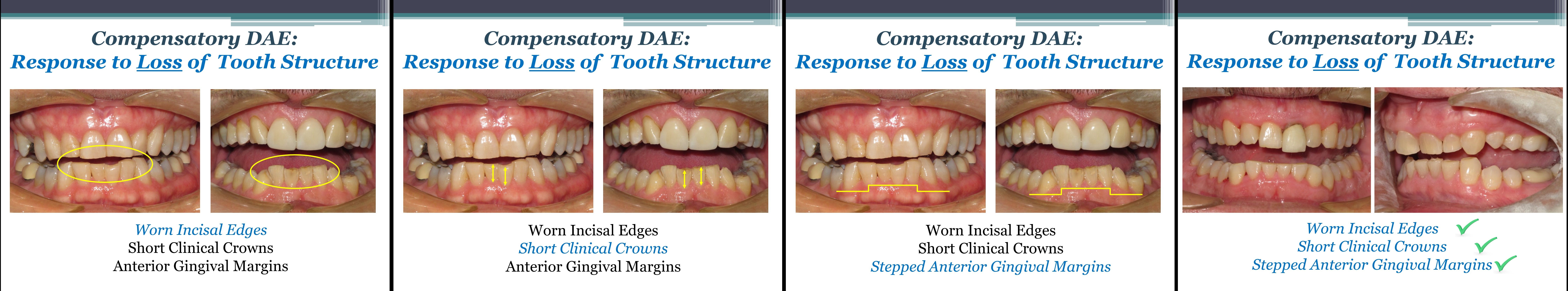 Dento-Alveolar Eruption explained ...Part 1: Anterior - Spear Talk