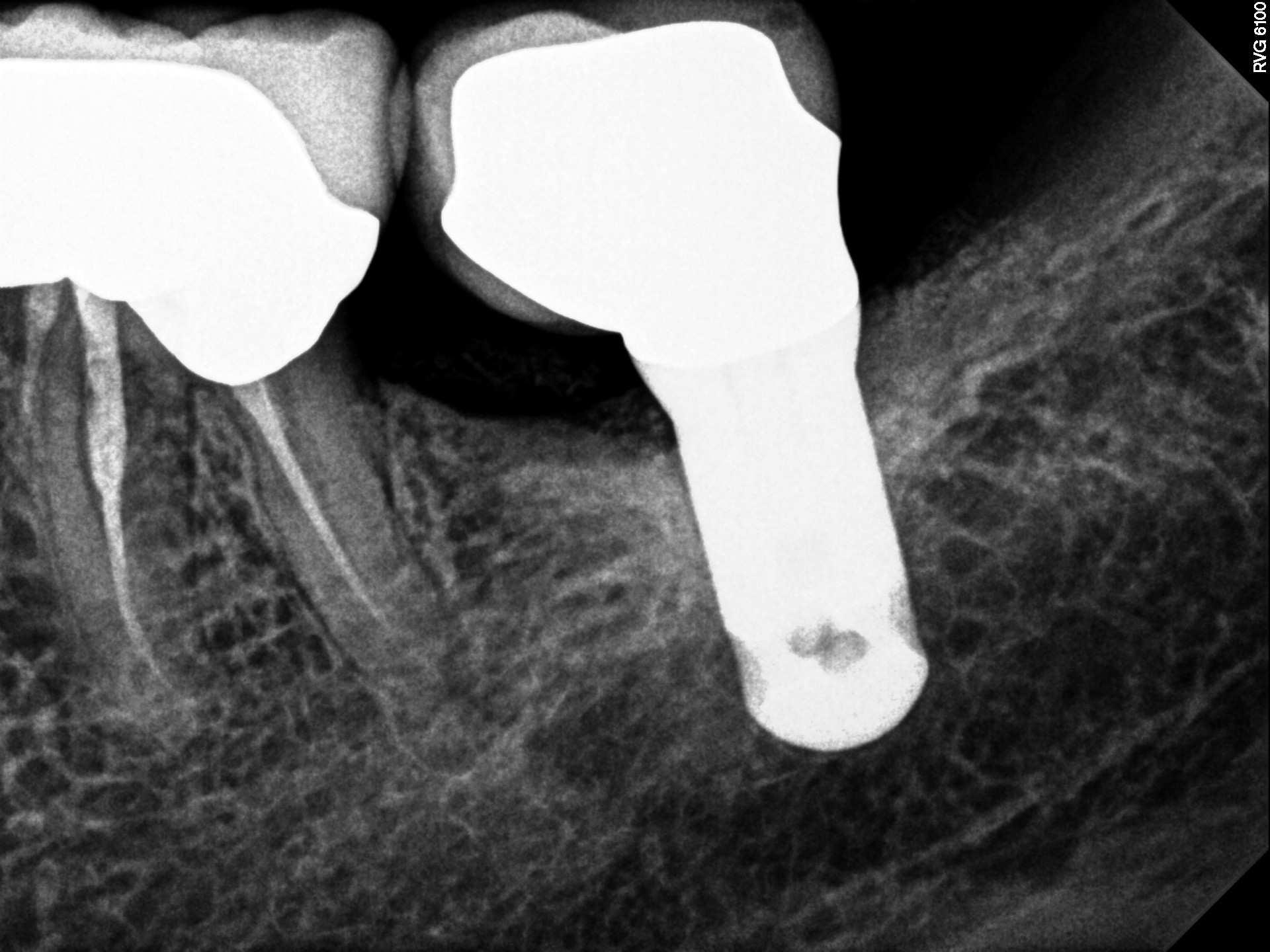 Help identifying an old implant, Please - Spear Talk