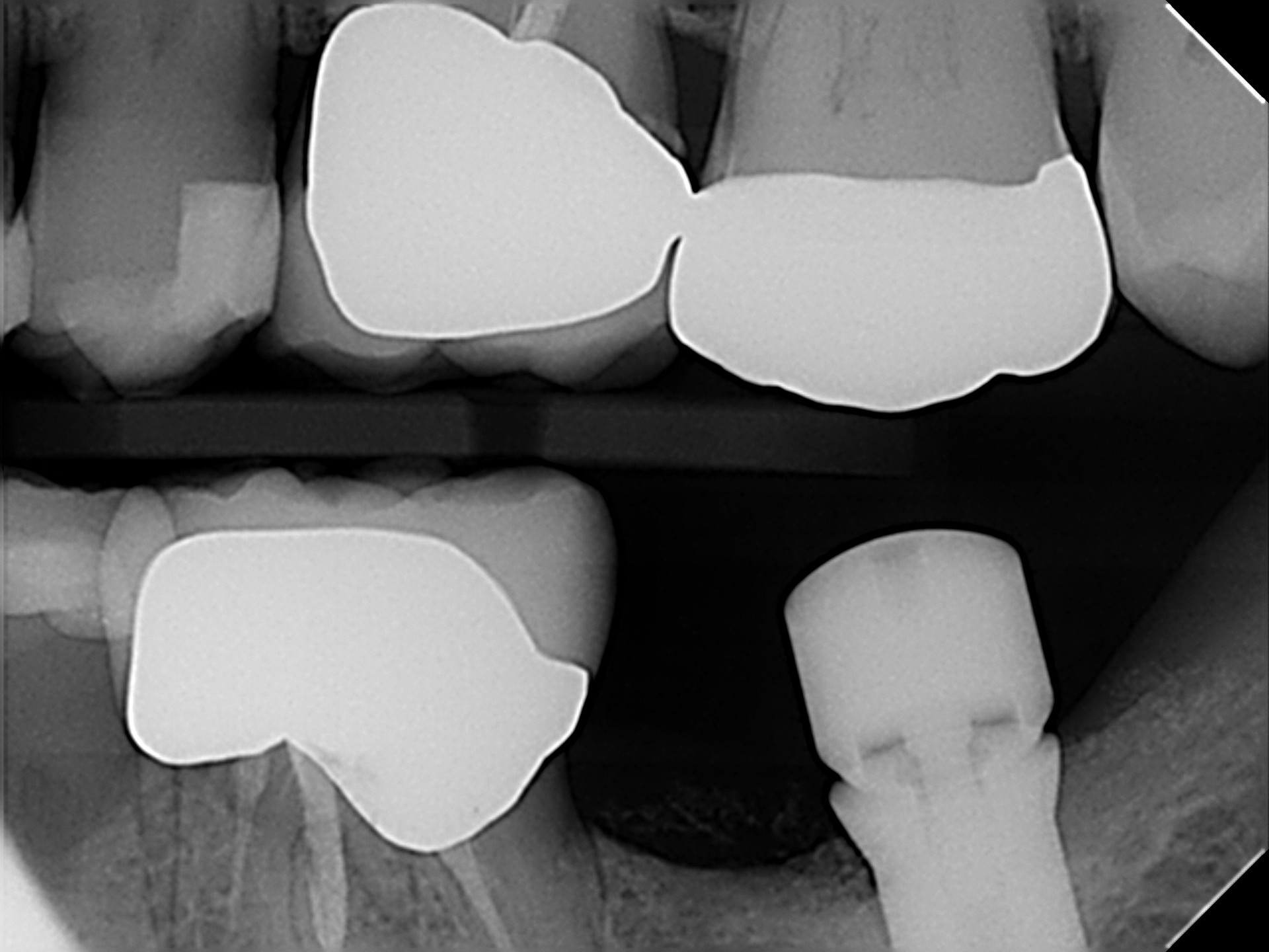 Help identifying an old implant, Please - Spear Talk