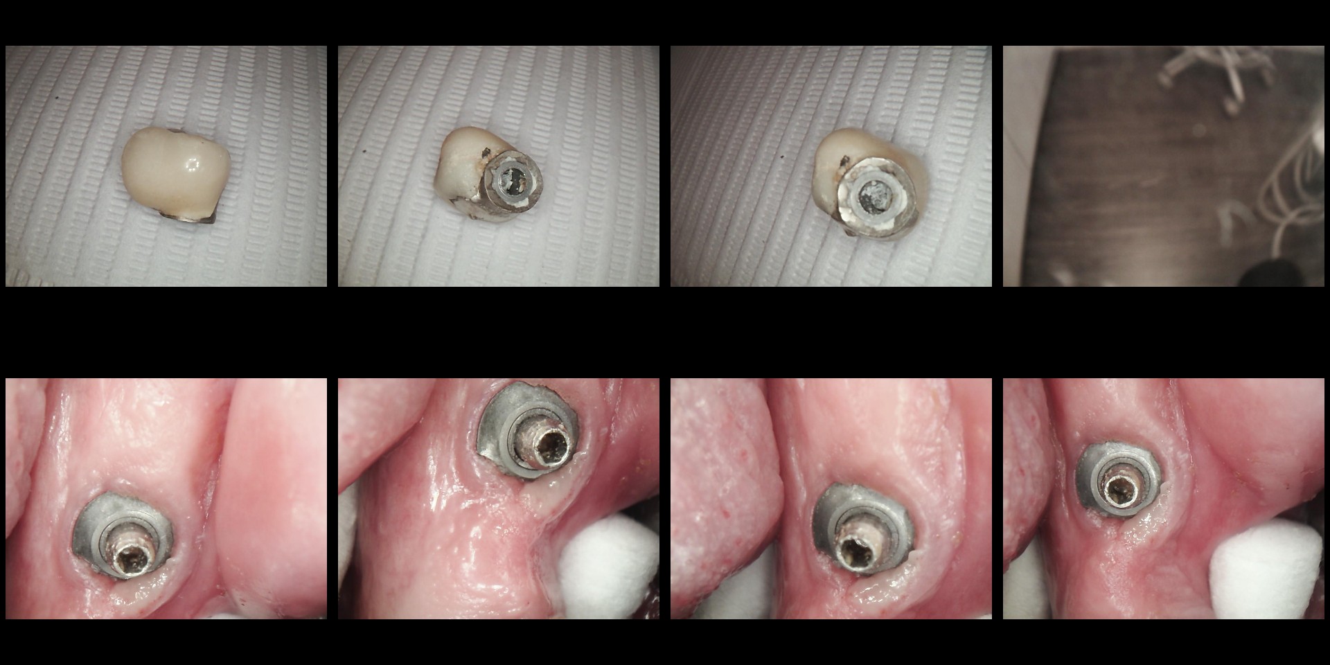 Help identifying an old implant, Please - Spear Talk