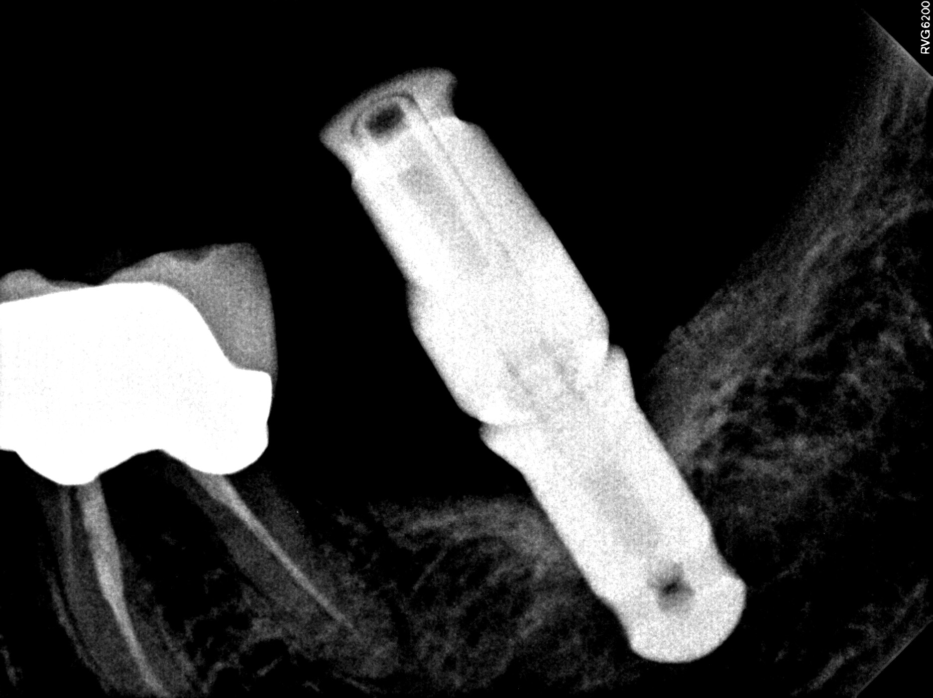 Help identifying an old implant, Please - Spear Talk