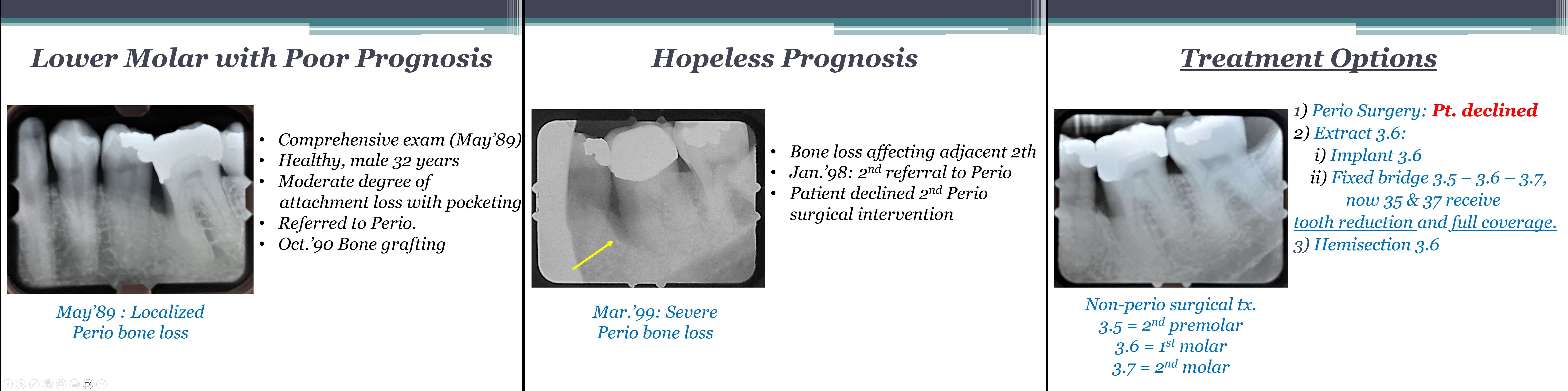 When a Hopeless tooth is still useful...Part 1: Hemisection - Spear Talk