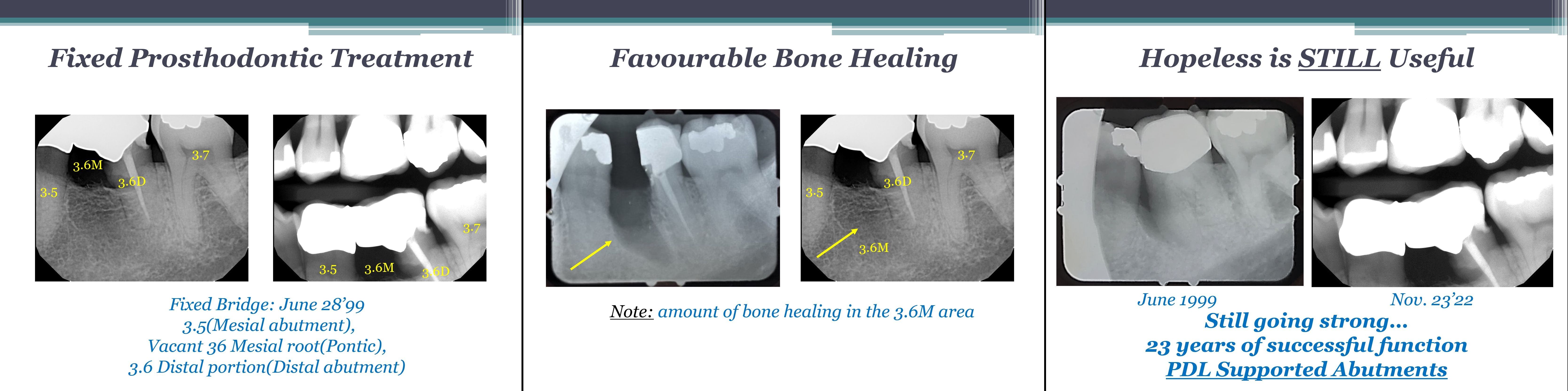 When a Hopeless tooth is still useful...Part 1: Hemisection - Spear Talk