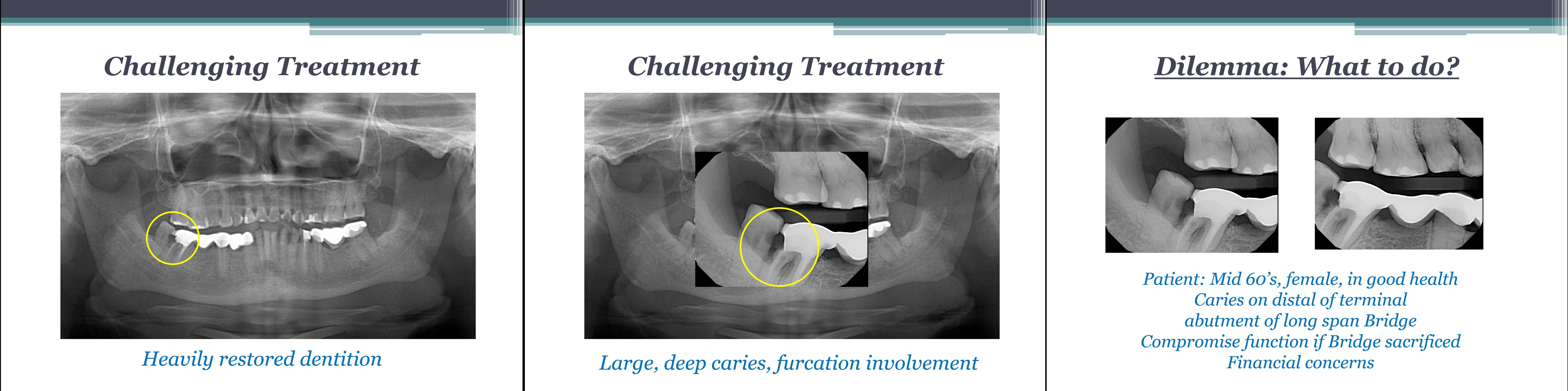 When a Hopeless tooth is still useful...Part 1: Hemisection - Spear Talk