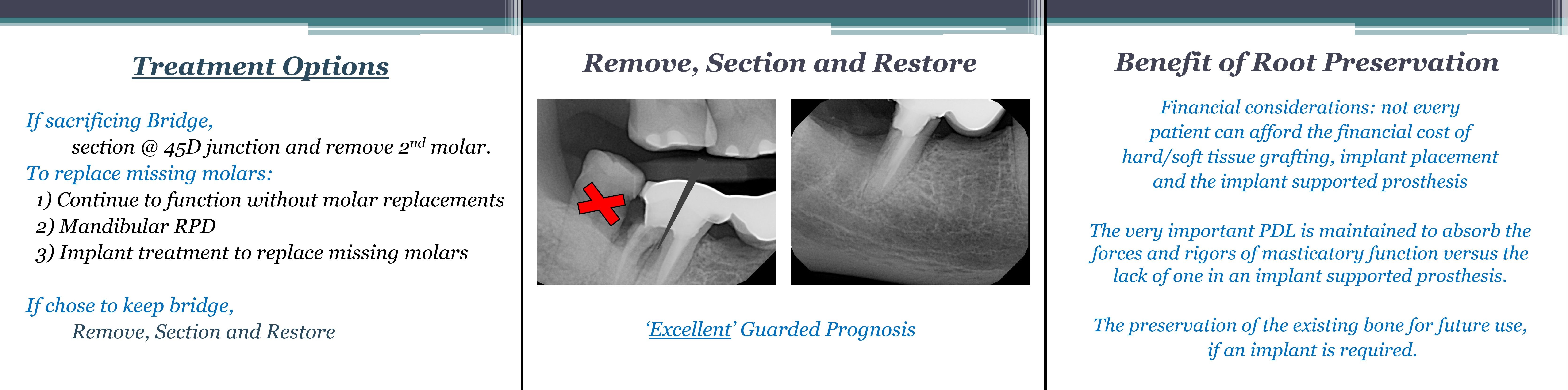 When a Hopeless tooth is still useful...Part 1: Hemisection - Spear Talk
