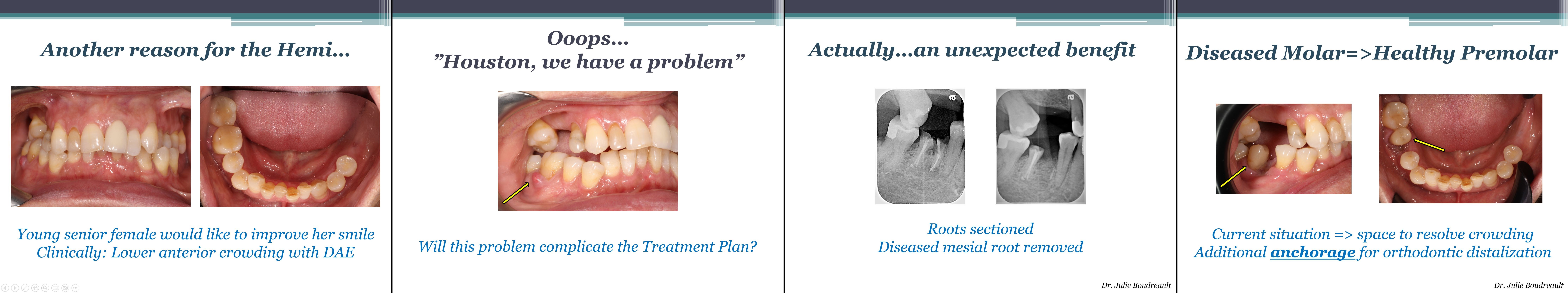 When a Hopeless tooth is still useful...Part 1: Hemisection - Spear Talk