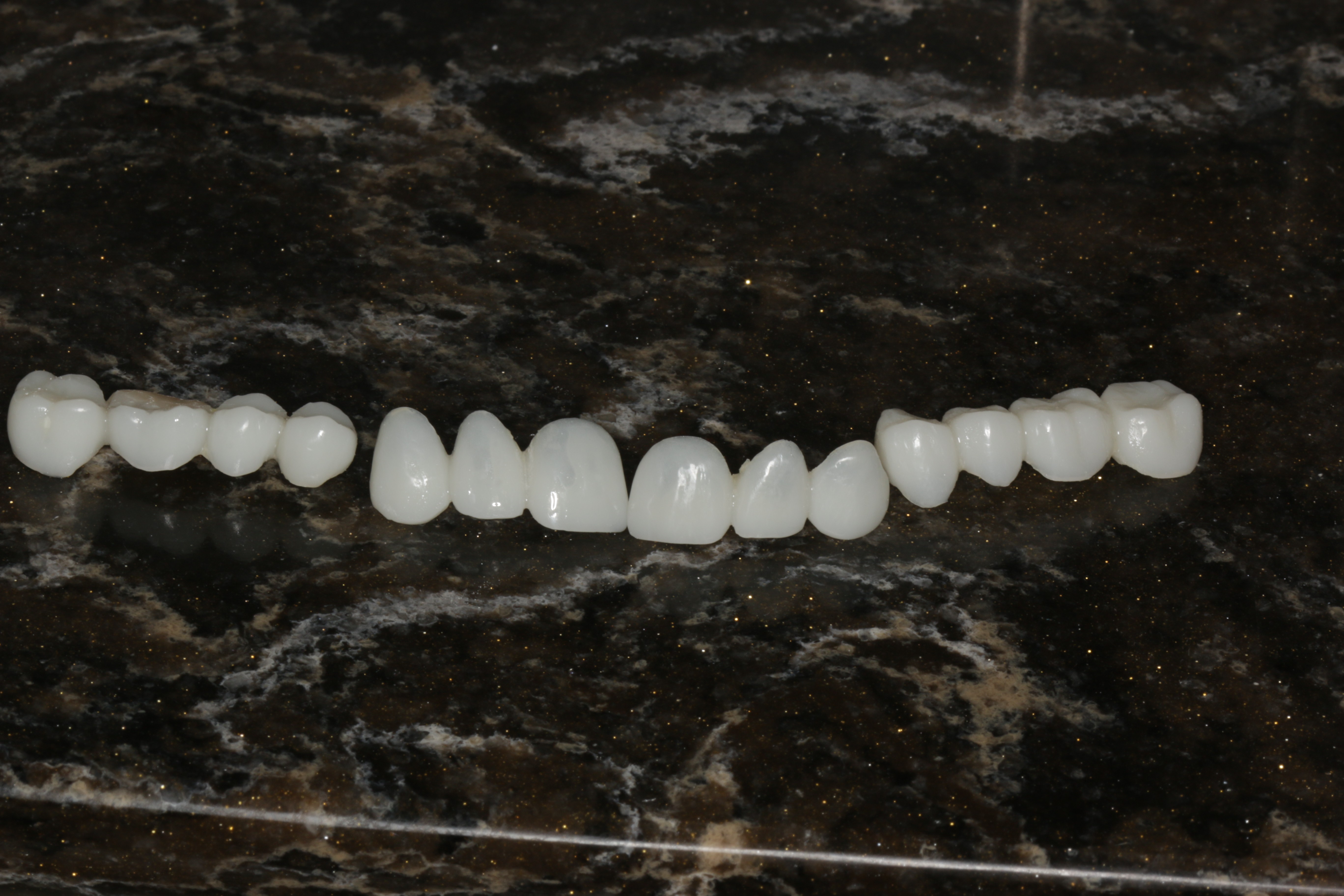 Anterior Bridge w/ Black Triangles at Delivery - Spear Talk