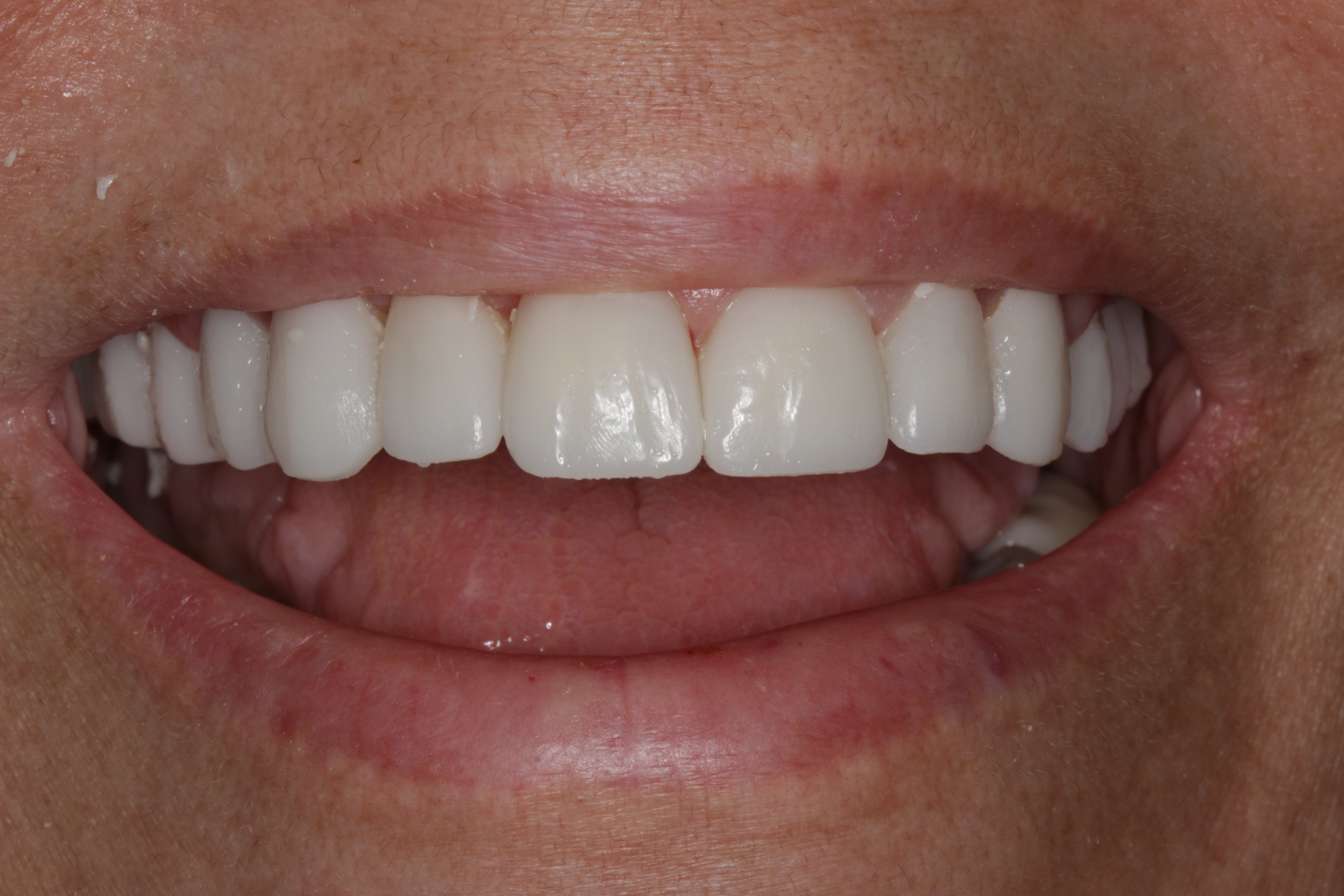 Anterior Bridge w/ Black Triangles at Delivery - Spear Talk