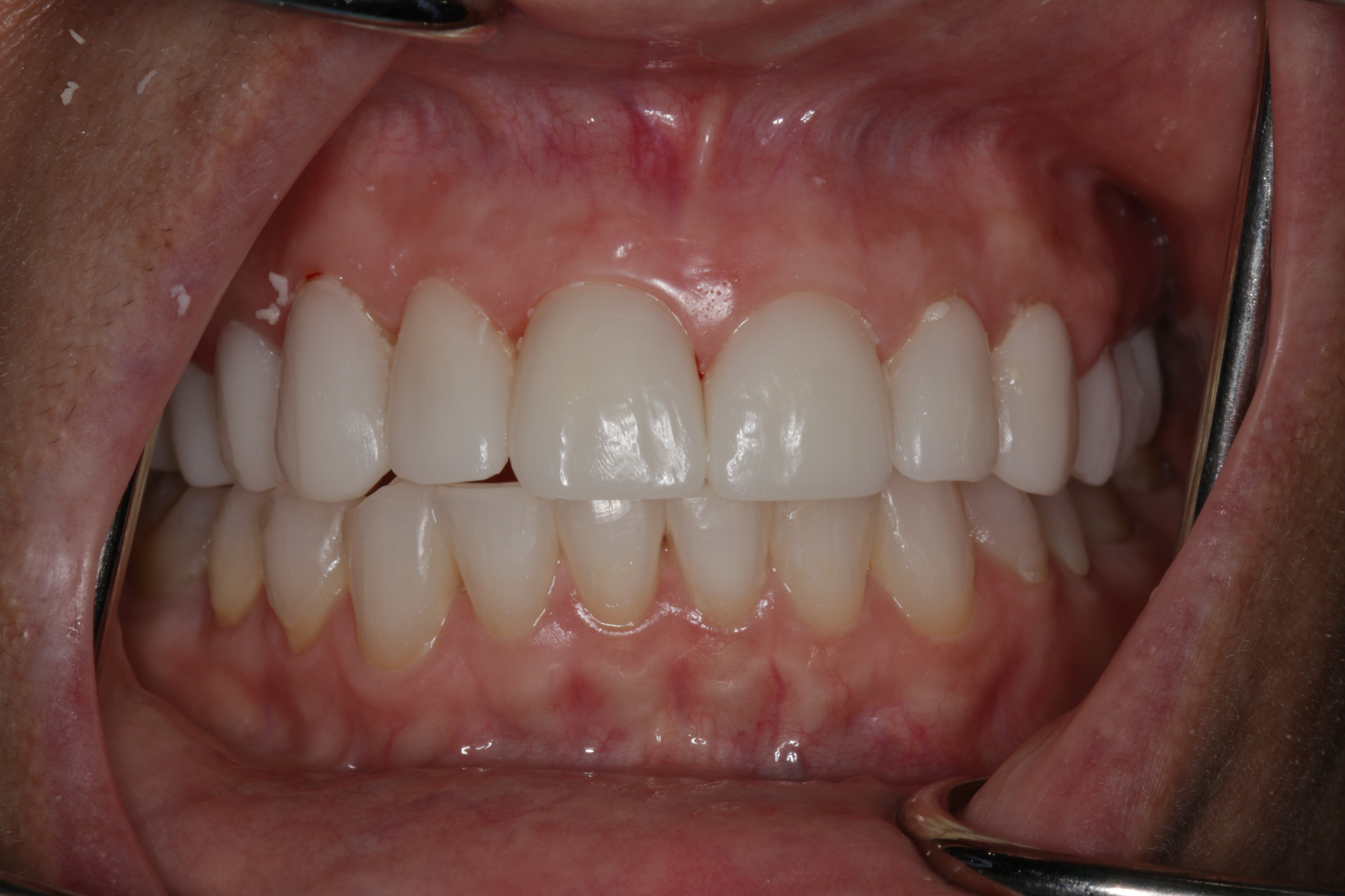 Anterior Bridge w/ Black Triangles at Delivery - Spear Talk