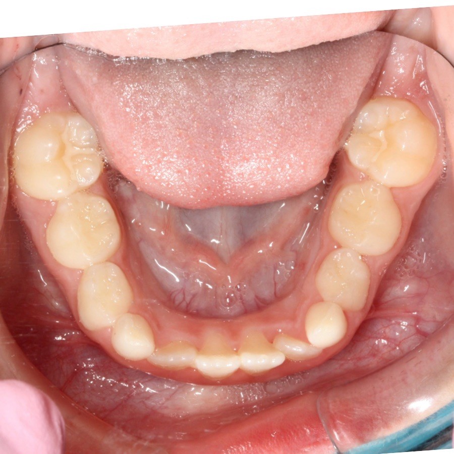 What caused this ortho relapse? - Spear Talk