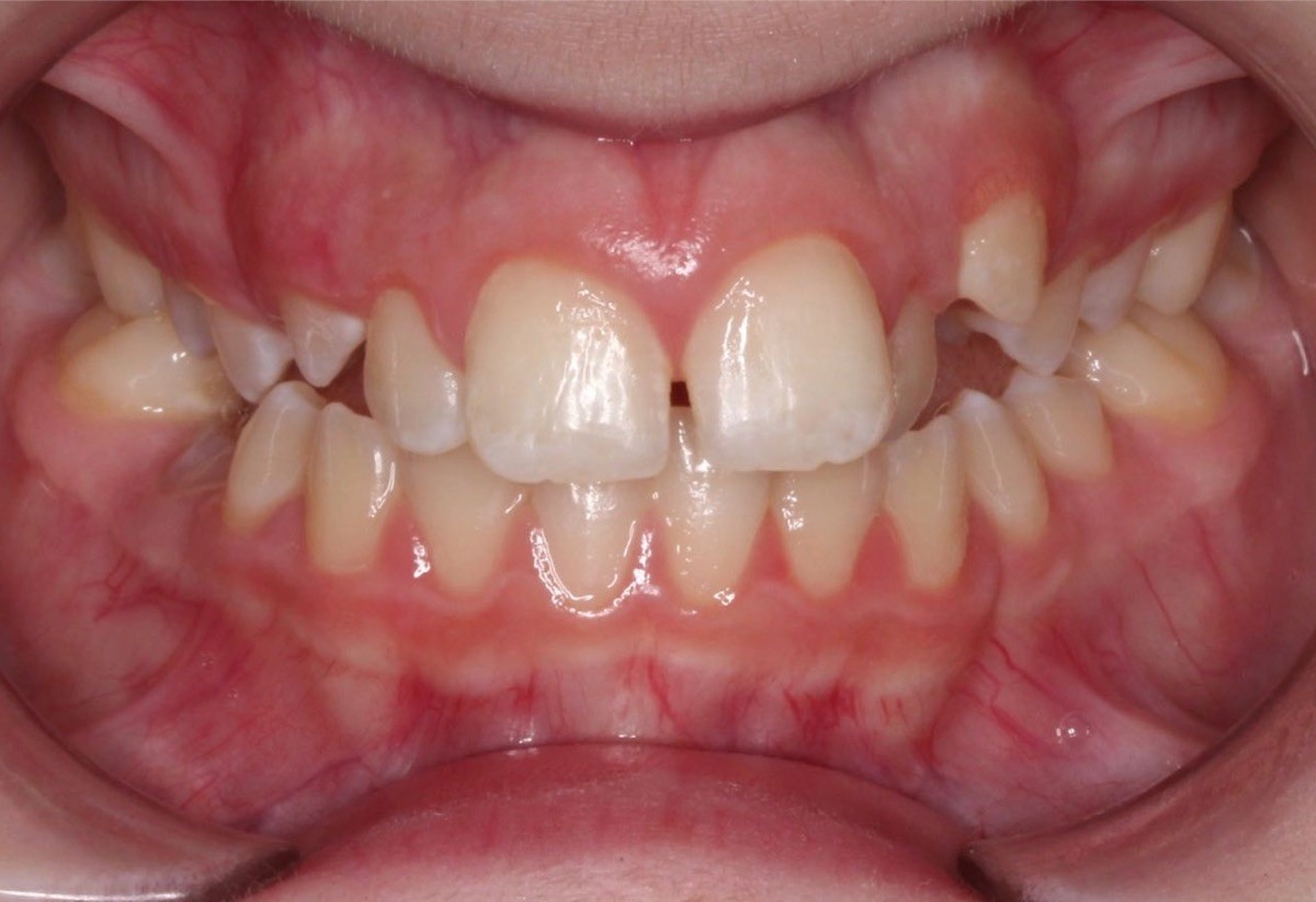 What caused this ortho relapse? - Spear Talk