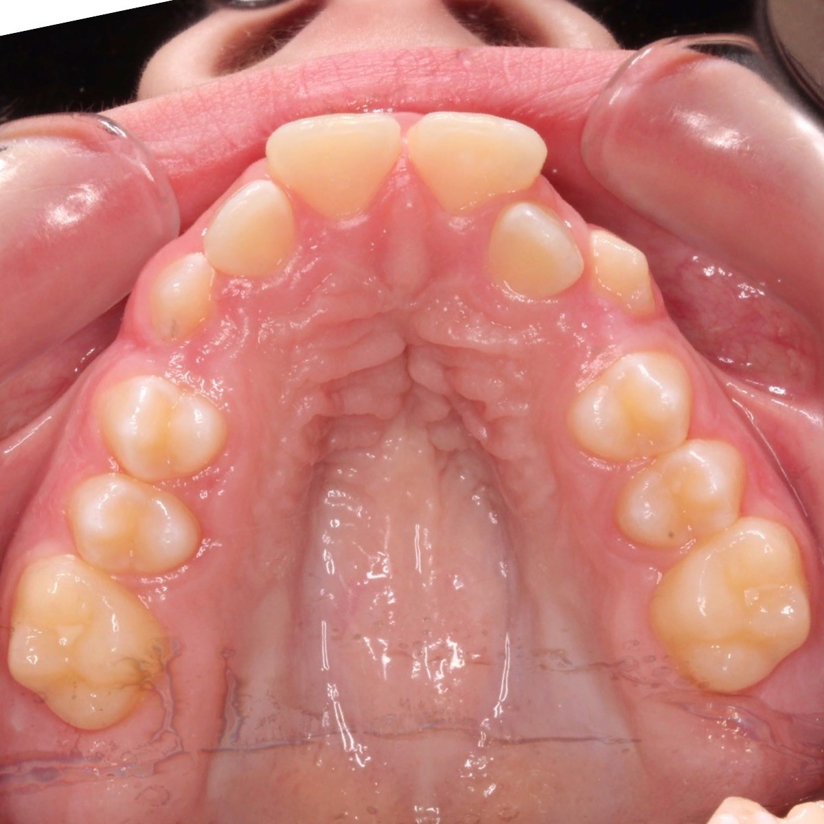 What caused this ortho relapse? - Spear Talk