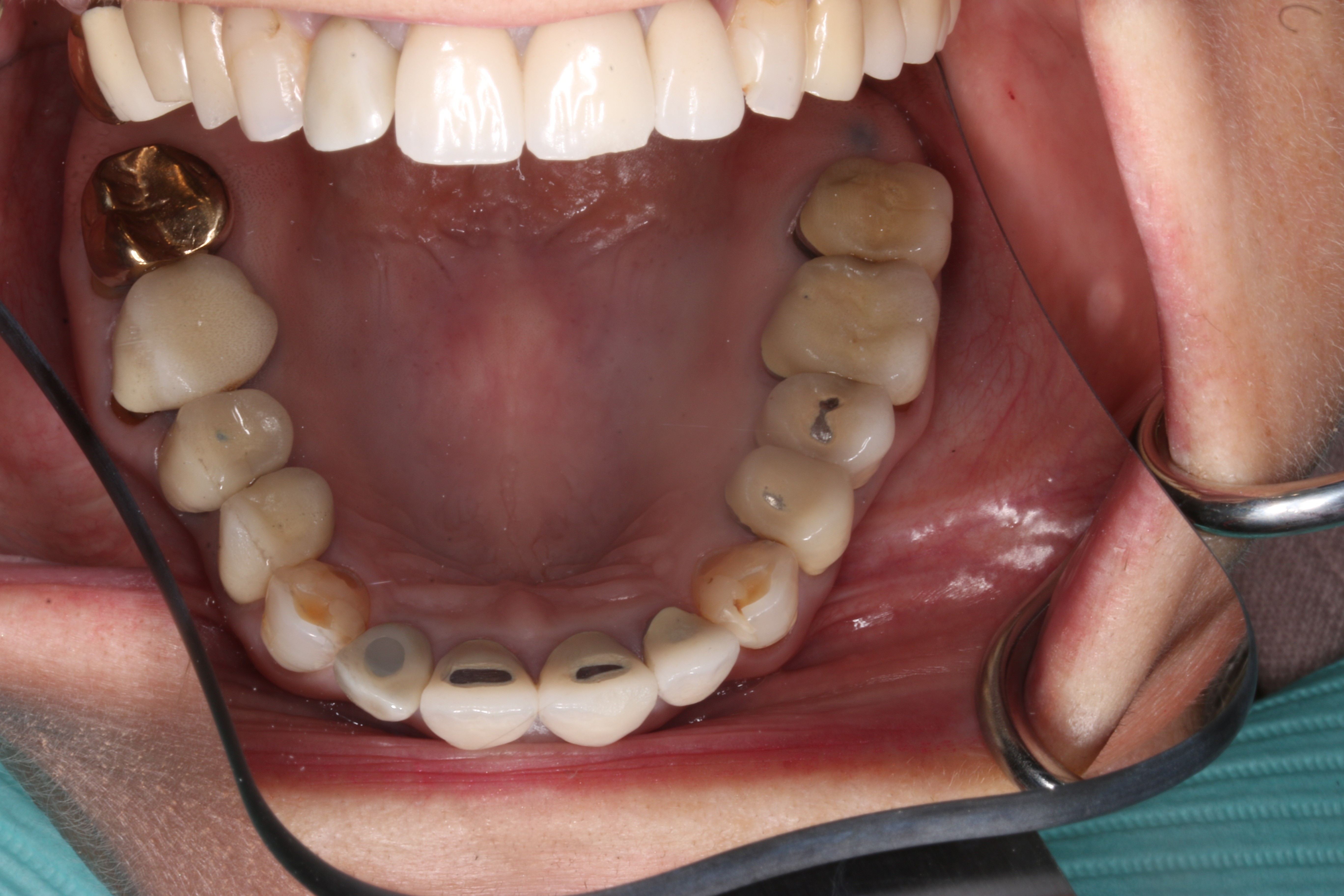 Airway Patient - help! - Spear Talk