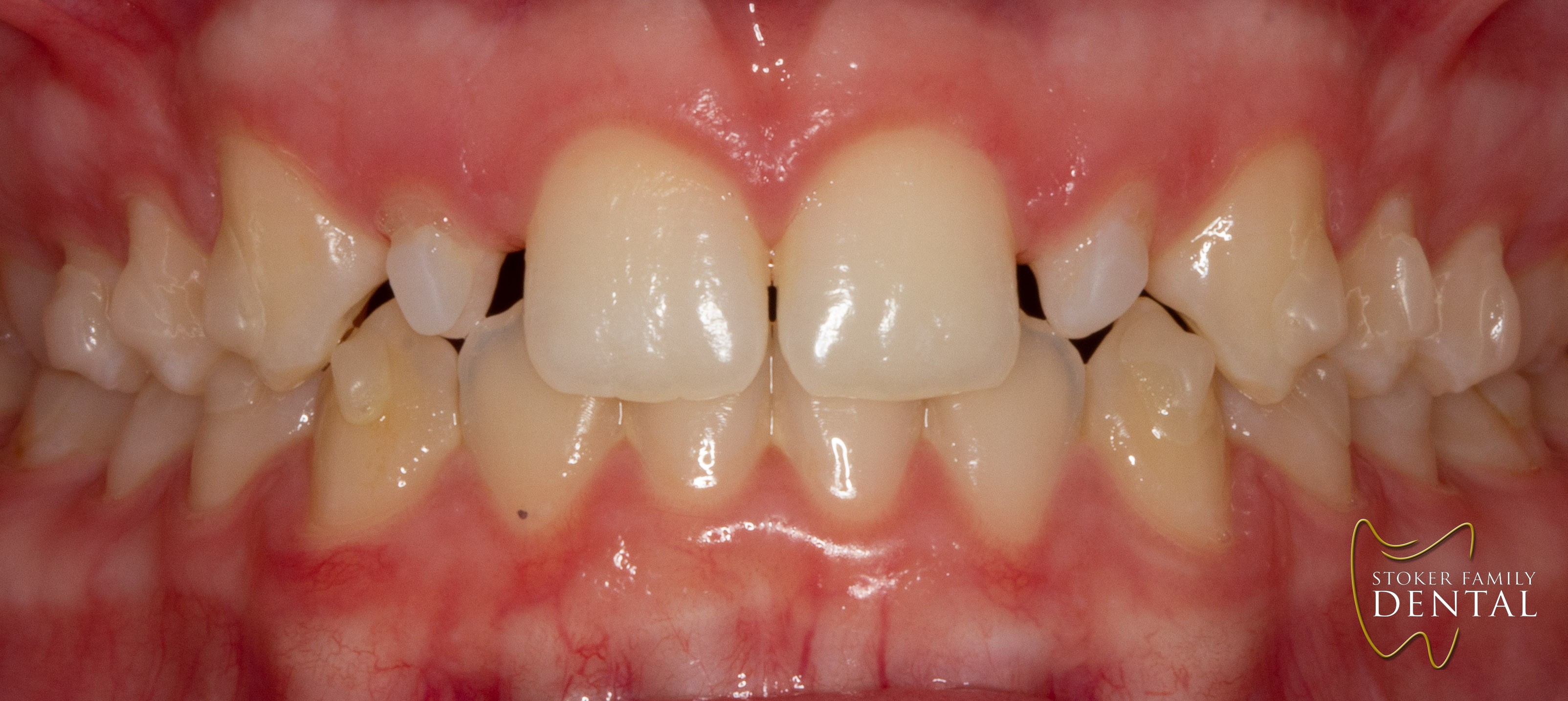 Suggestions for a peg lateral case - Spear Talk