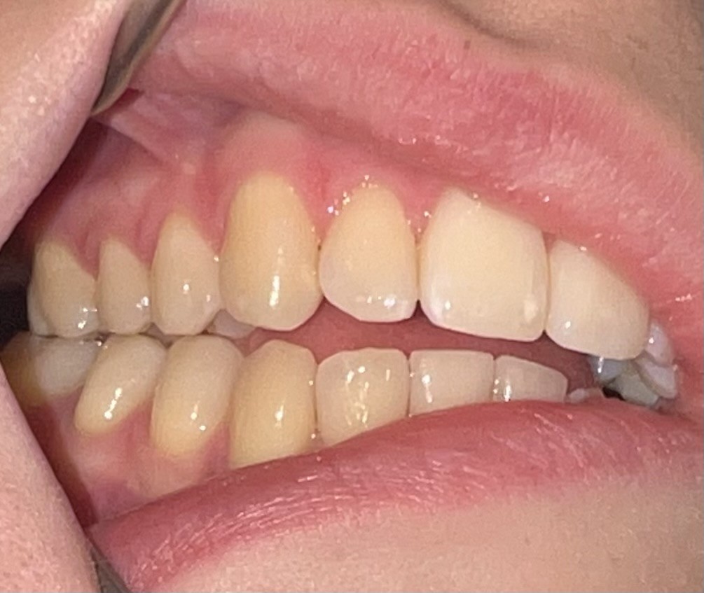 Sleep disorder, TMJ clicks.. where should we start? - Spear Talk