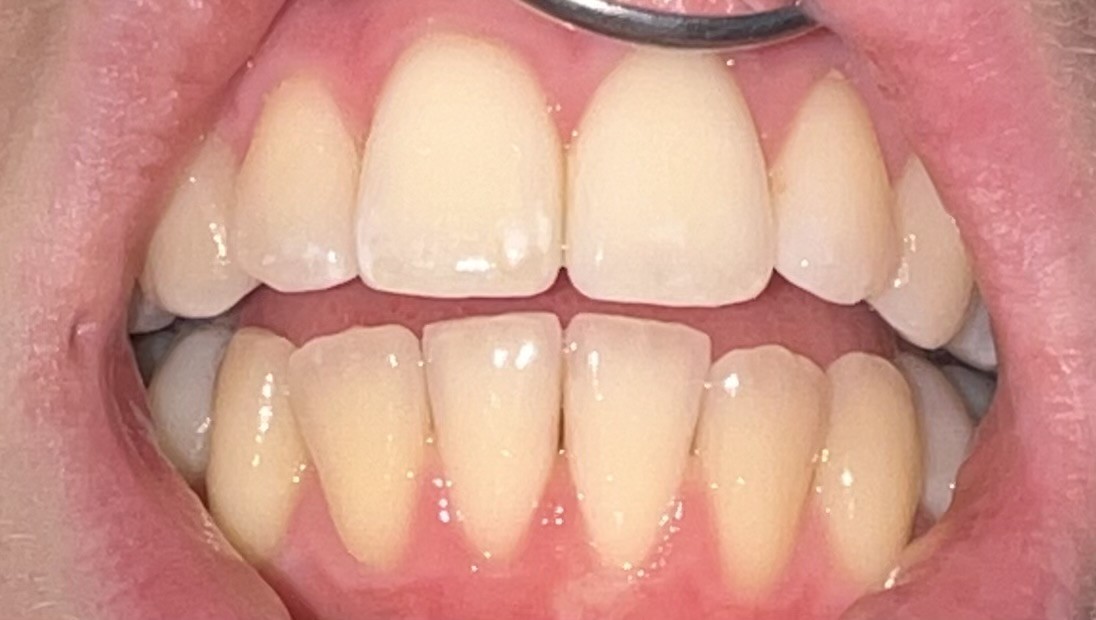 Sleep disorder, TMJ clicks.. where should we start? - Spear Talk