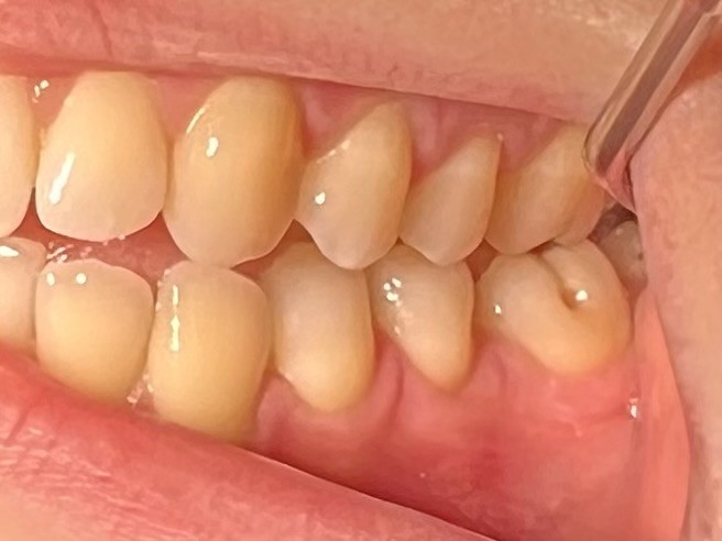 Sleep disorder, TMJ clicks.. where should we start? - Spear Talk