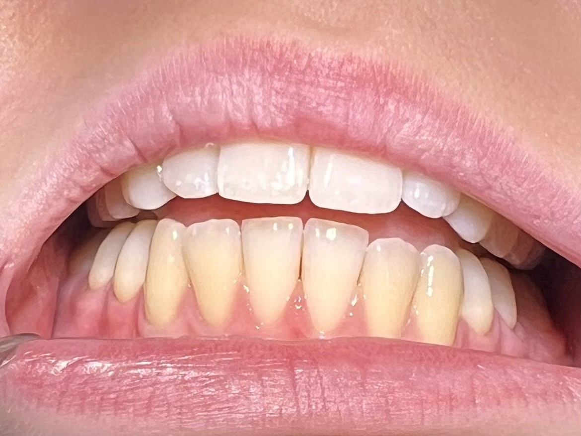 Sleep disorder, TMJ clicks.. where should we start? - Spear Talk