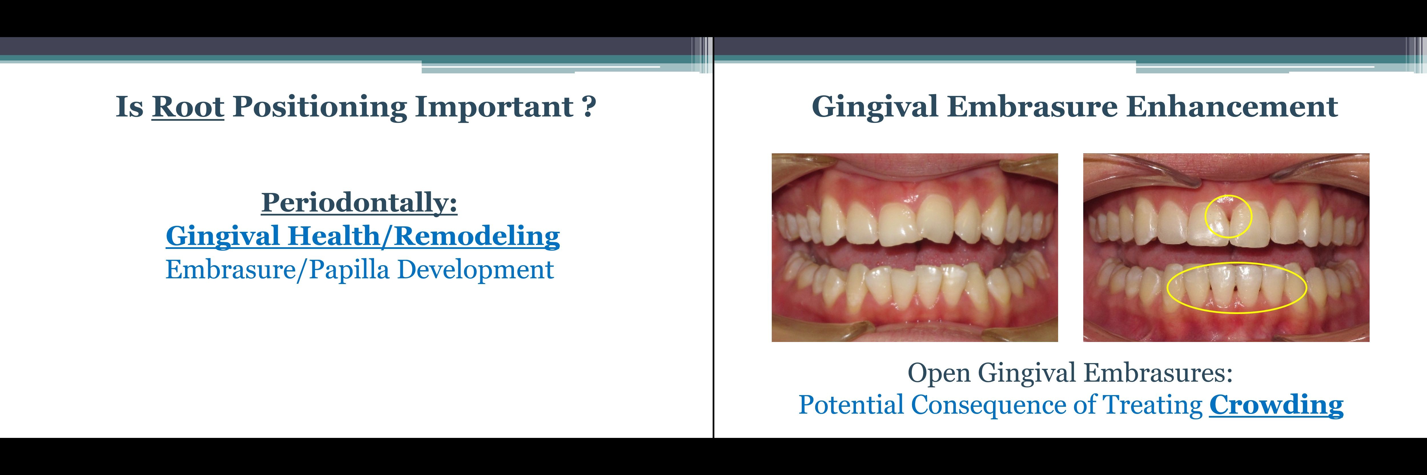 Non-surgical Gingival remodeling - Spear Talk