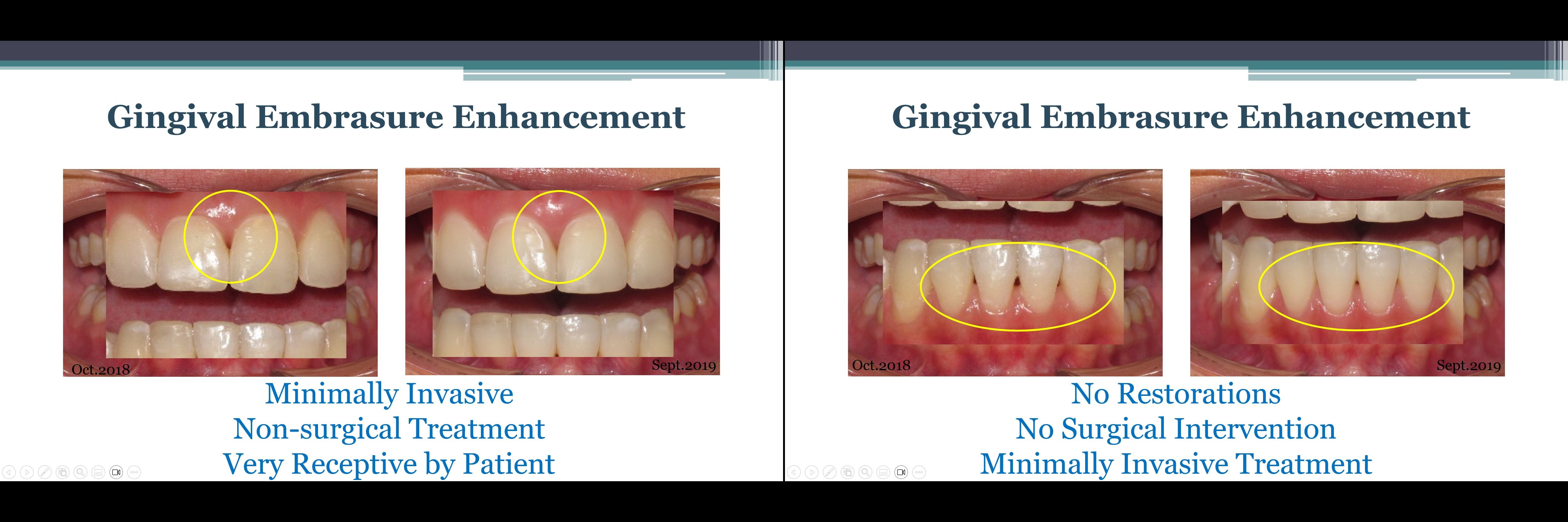 Non-surgical Gingival remodeling - Spear Talk