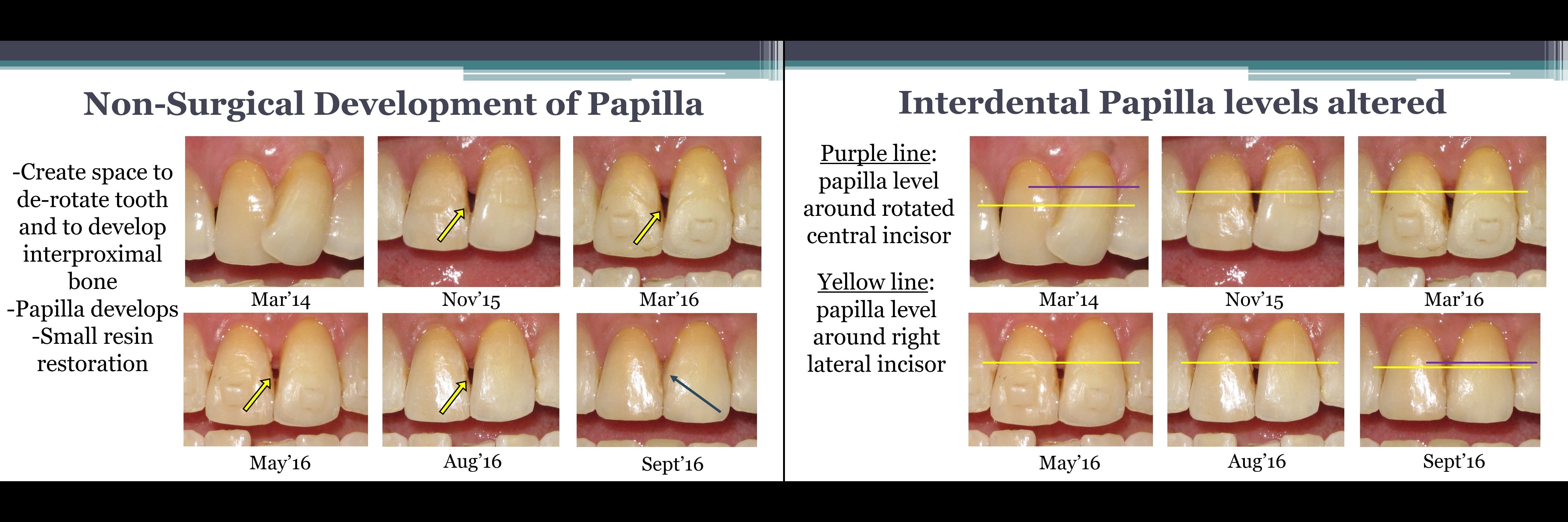 Non-surgical Gingival remodeling - Spear Talk
