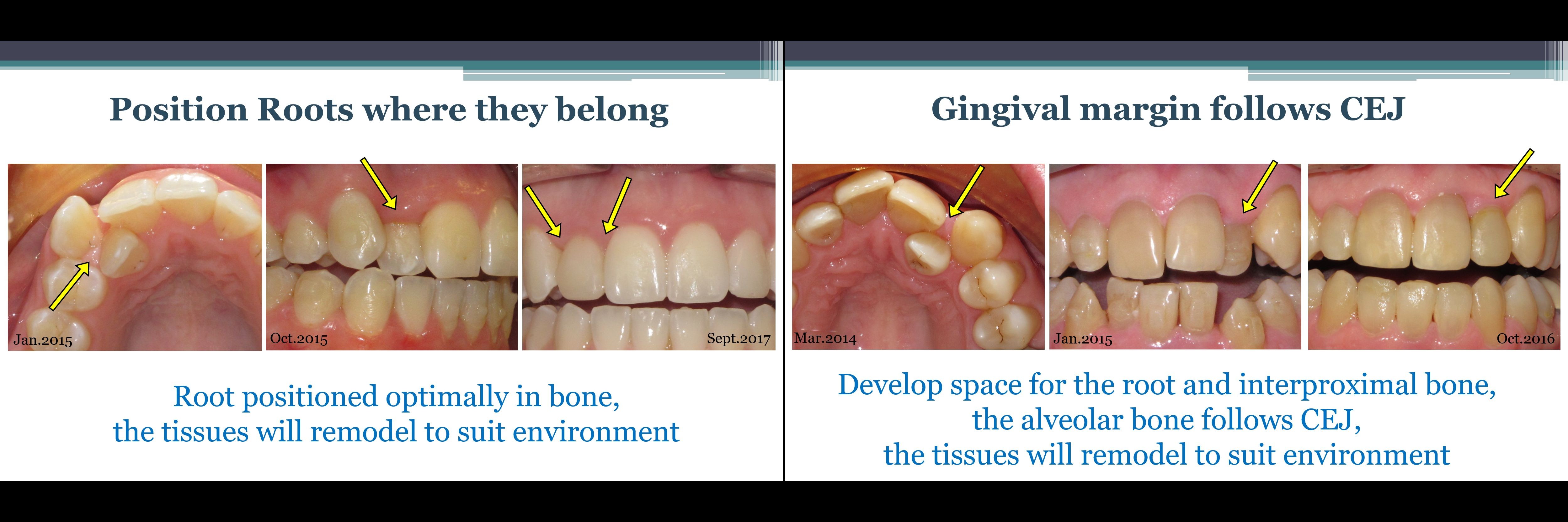 Non-surgical Gingival remodeling - Spear Talk