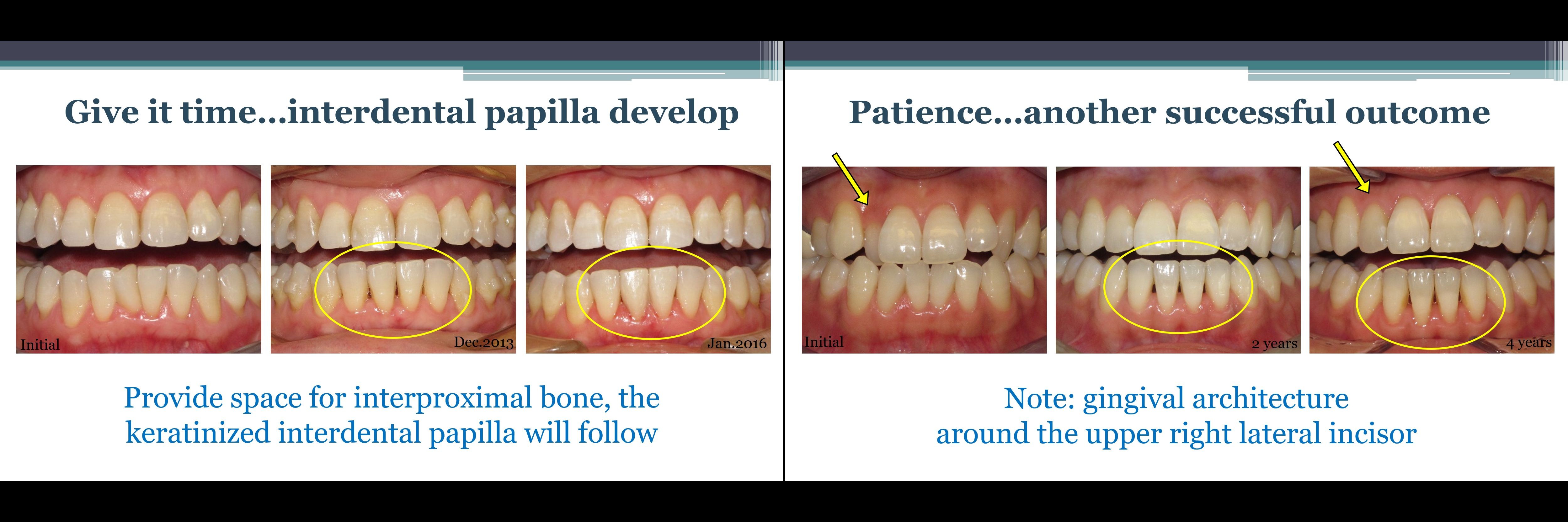 Non-surgical Gingival remodeling - Spear Talk