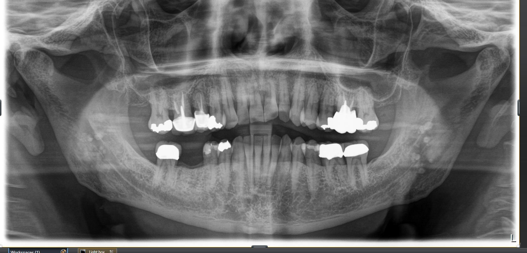 Radiographic interpretation of a Pano - Spear Talk